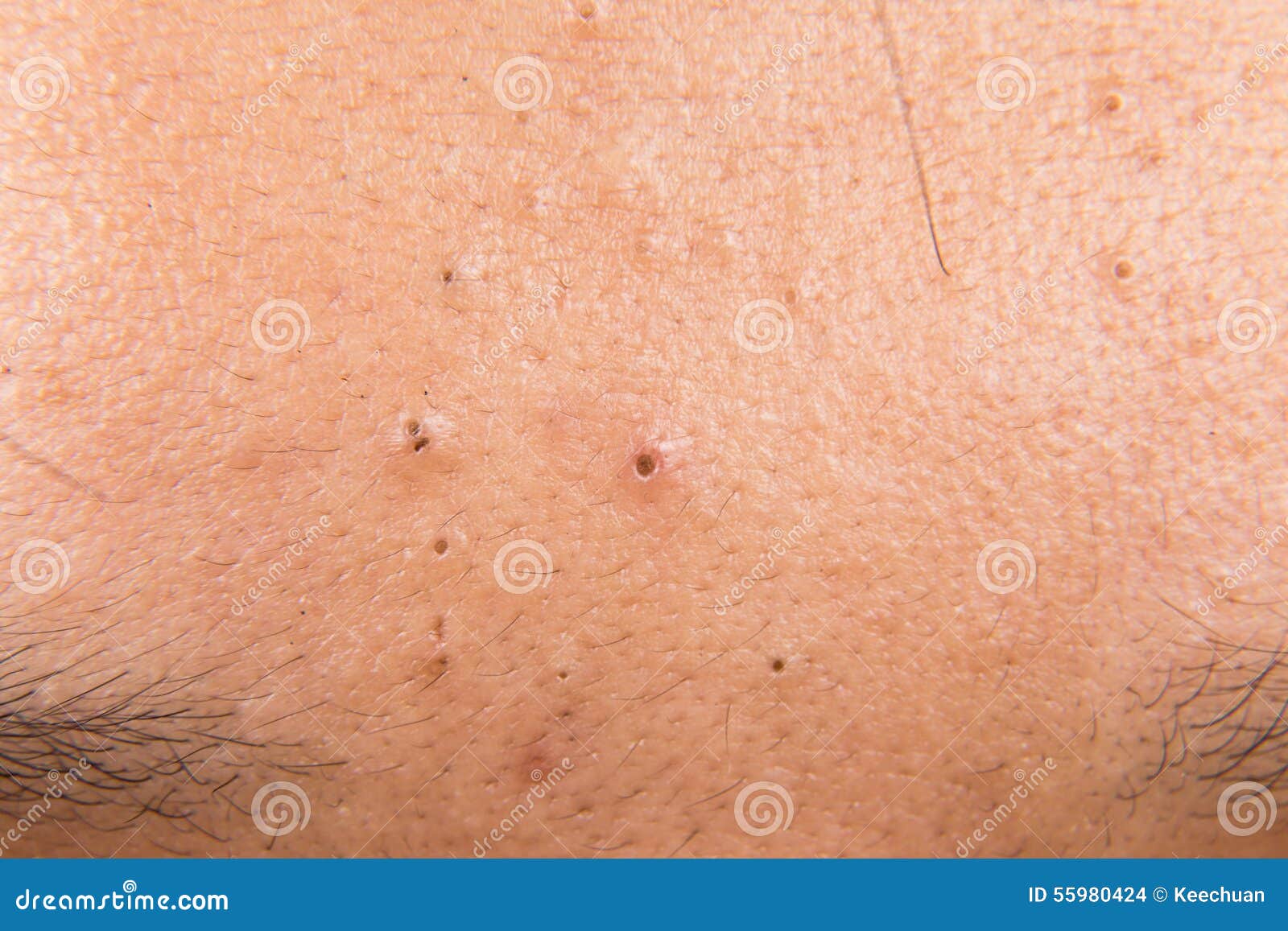 Ugly Pimples, Acne, Zit and Blackheads on the Forehead of a Teenager ... Ugly Pimples, Acne, Zit and Blackheads on the Forehead of a Teenager ...