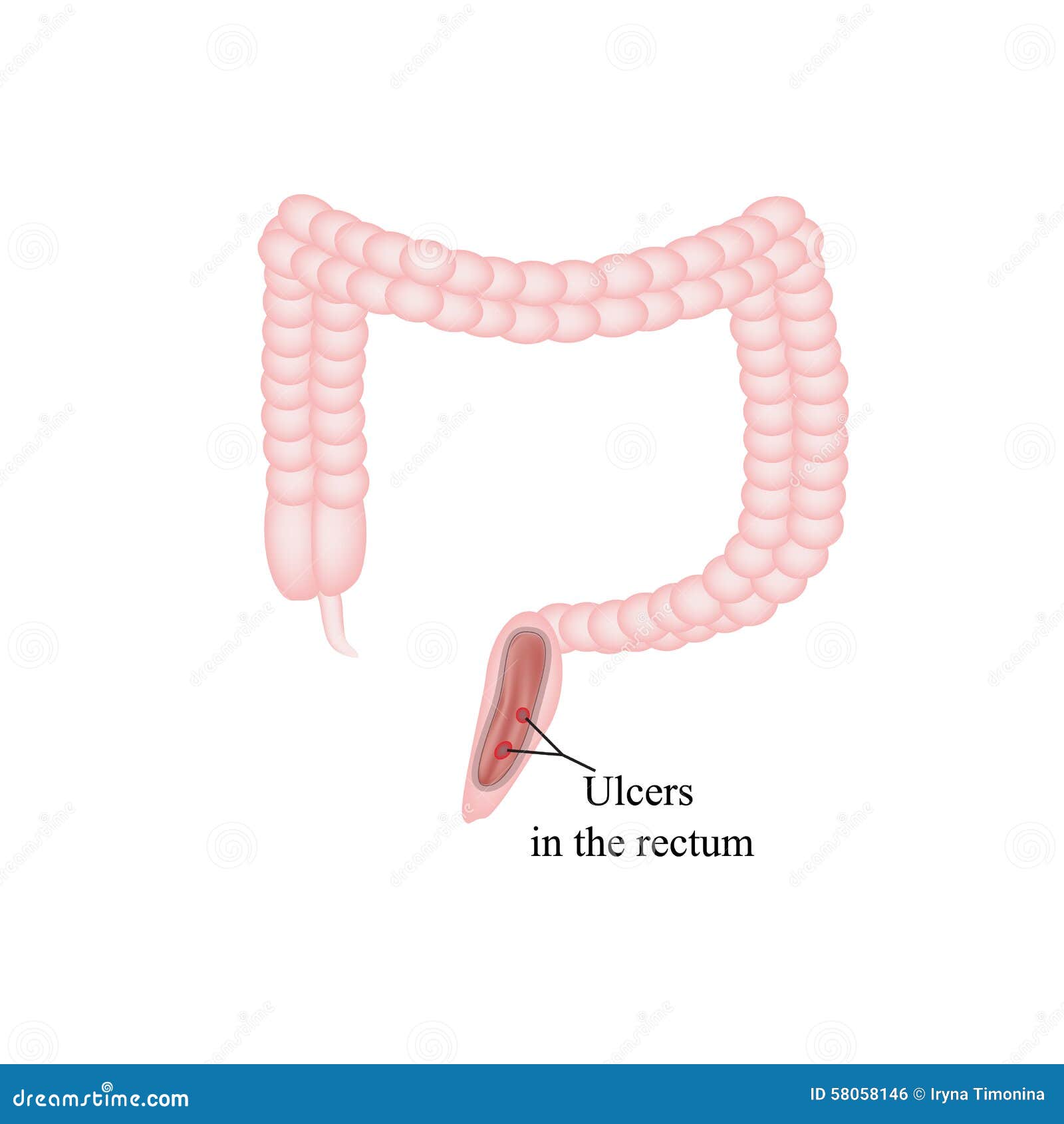 An Ulcer in the Rectum. Ulcers in the Intestines Stock Vector ...