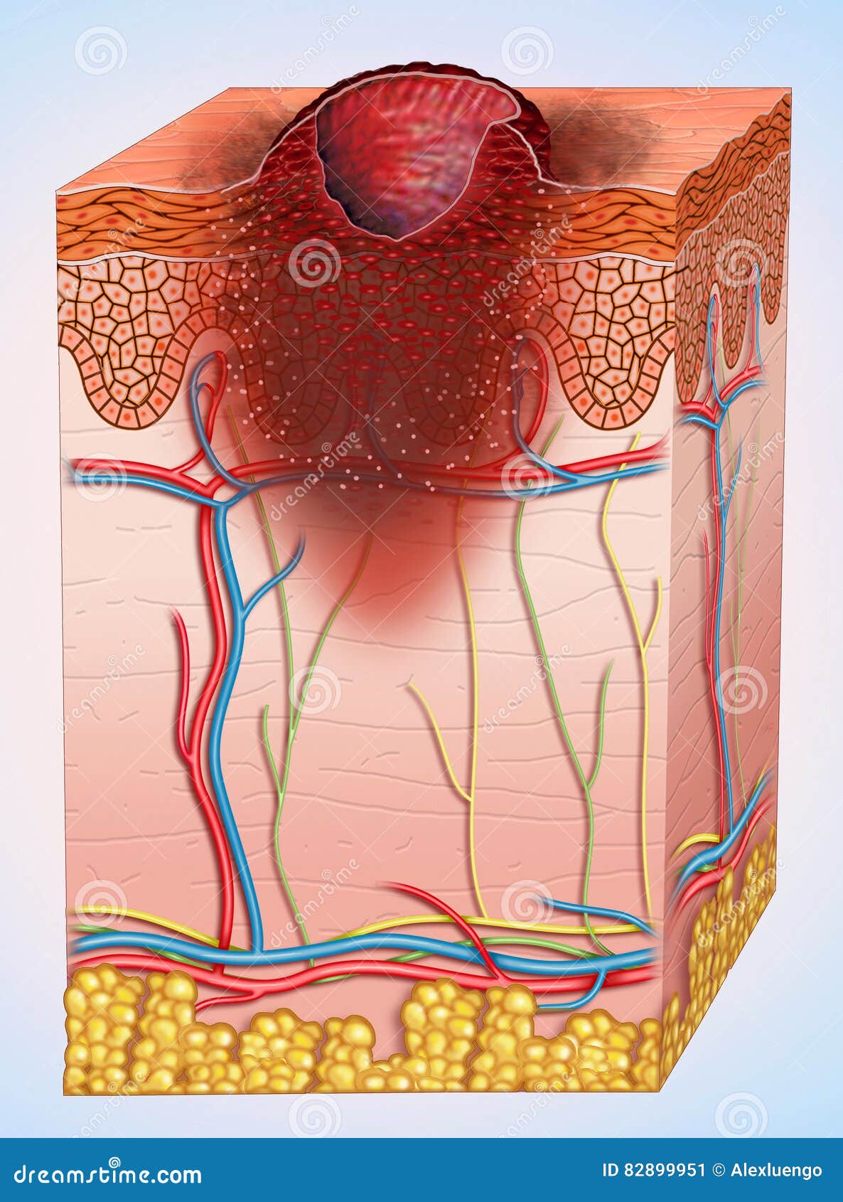 Ulcerated melanoma scheme stock illustration. Illustration of disease ...
