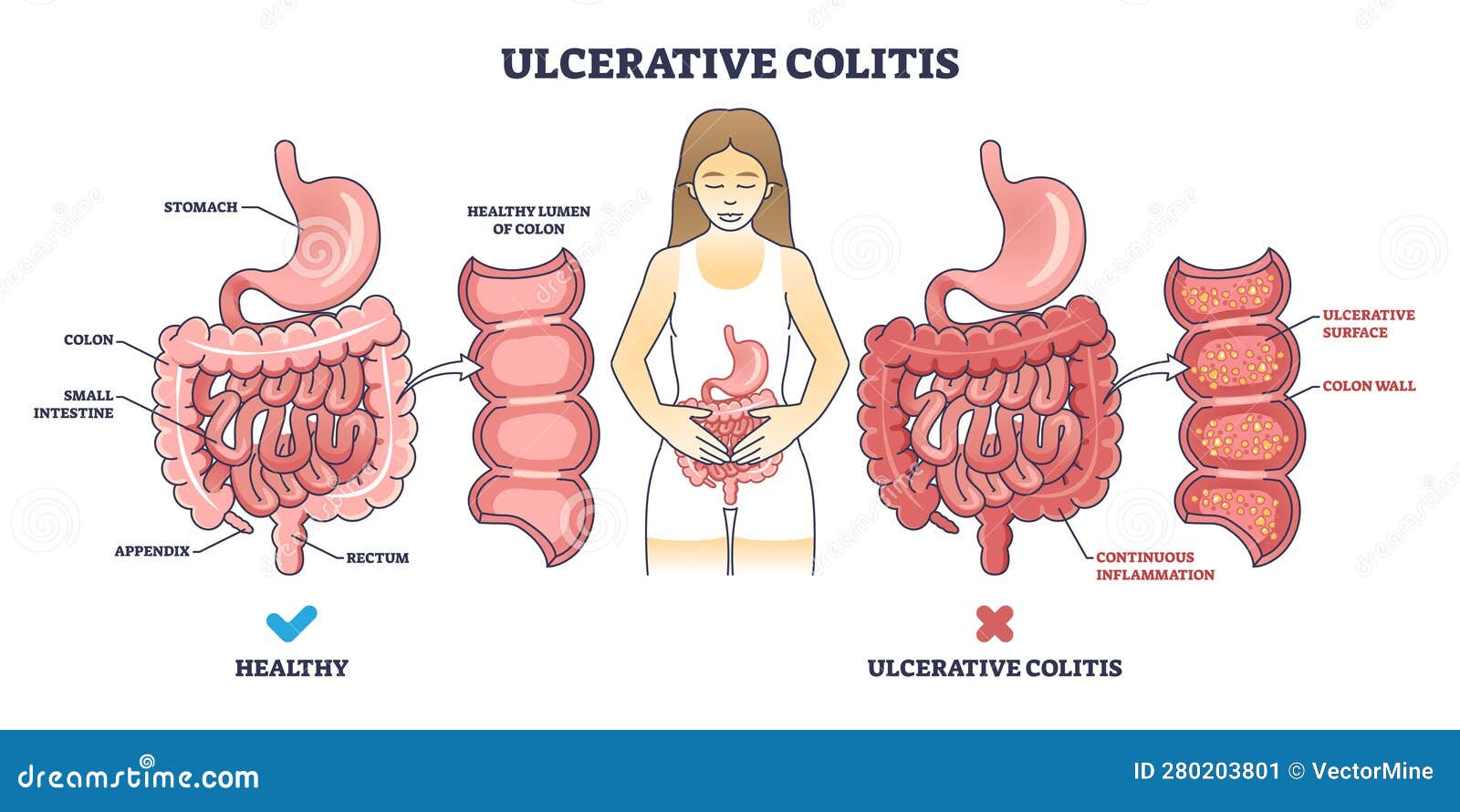 Ulcerative Colitis As Chronic Inflammatory Bowel Disease Outline ... Ulcerative Colitis As Chronic Inflammatory Bowel Disease Outline ...