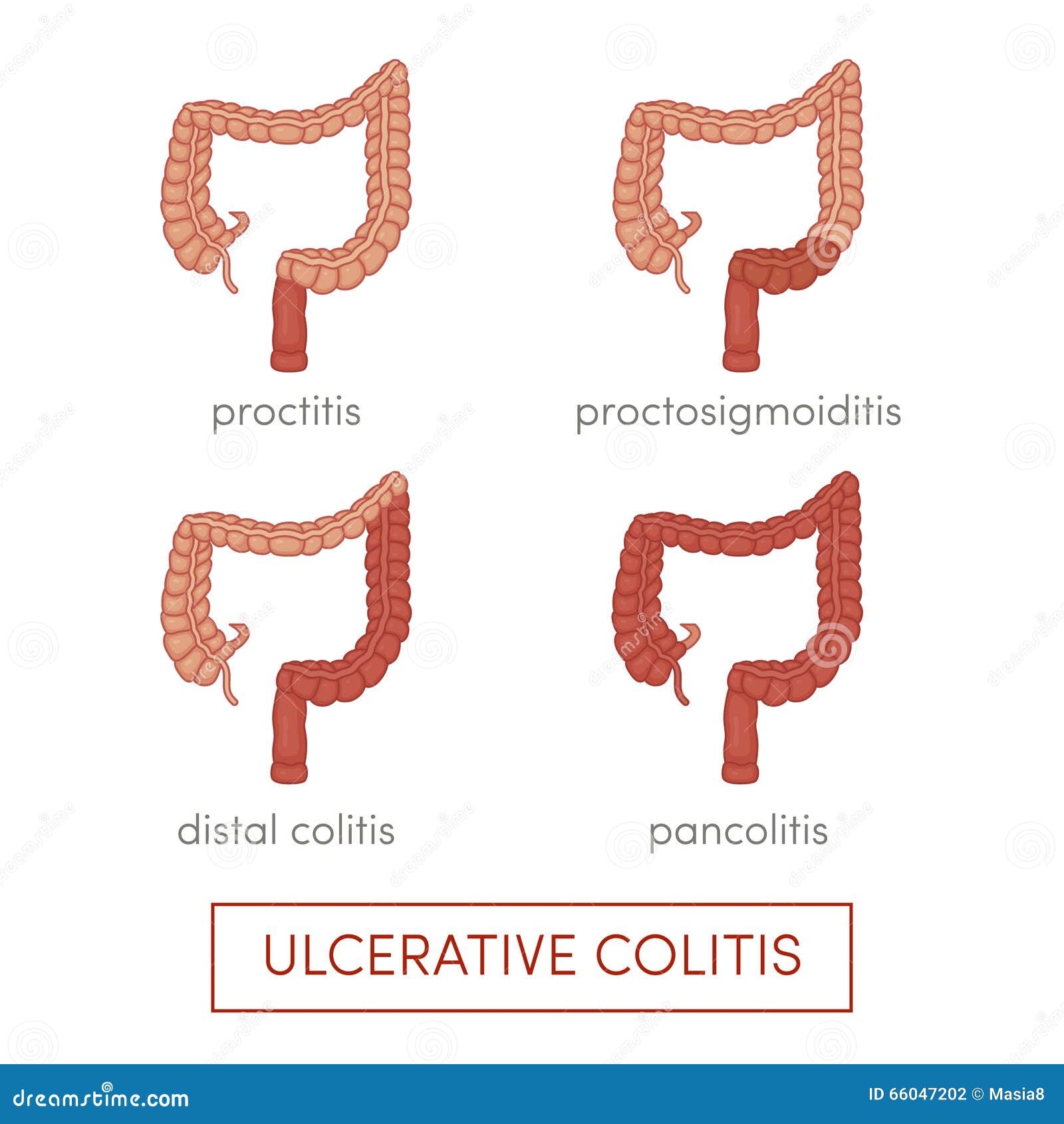 Types Of Ulcerative Colitis Cartoon Vector 51329155