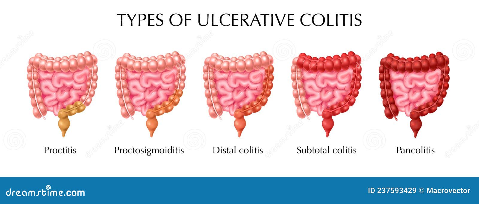 Ulcerative Colitis Types Infographics Stock Vector - Illustration of ...