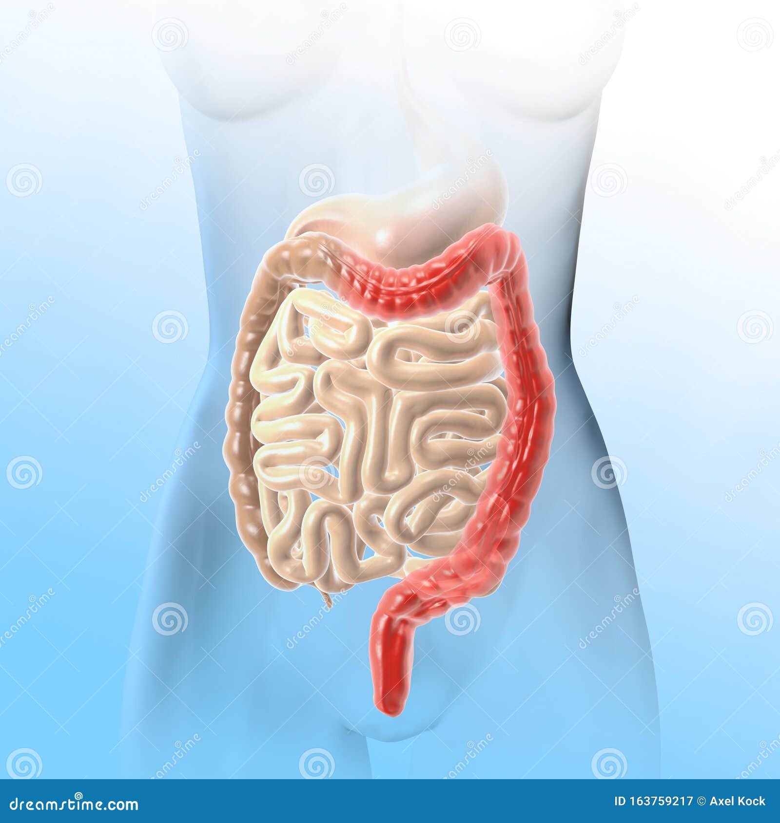 Ulcerative Colitis As Chronic Inflammatory Bowel Disease Outline ...