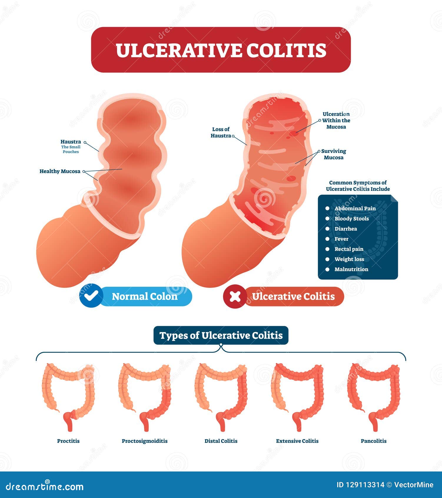 Types Of Ulcerative Colitis Cartoon Vector | CartoonDealer.com #51329155 Types Of Ulcerative Colitis Cartoon Vector | CartoonDealer.com #51329155