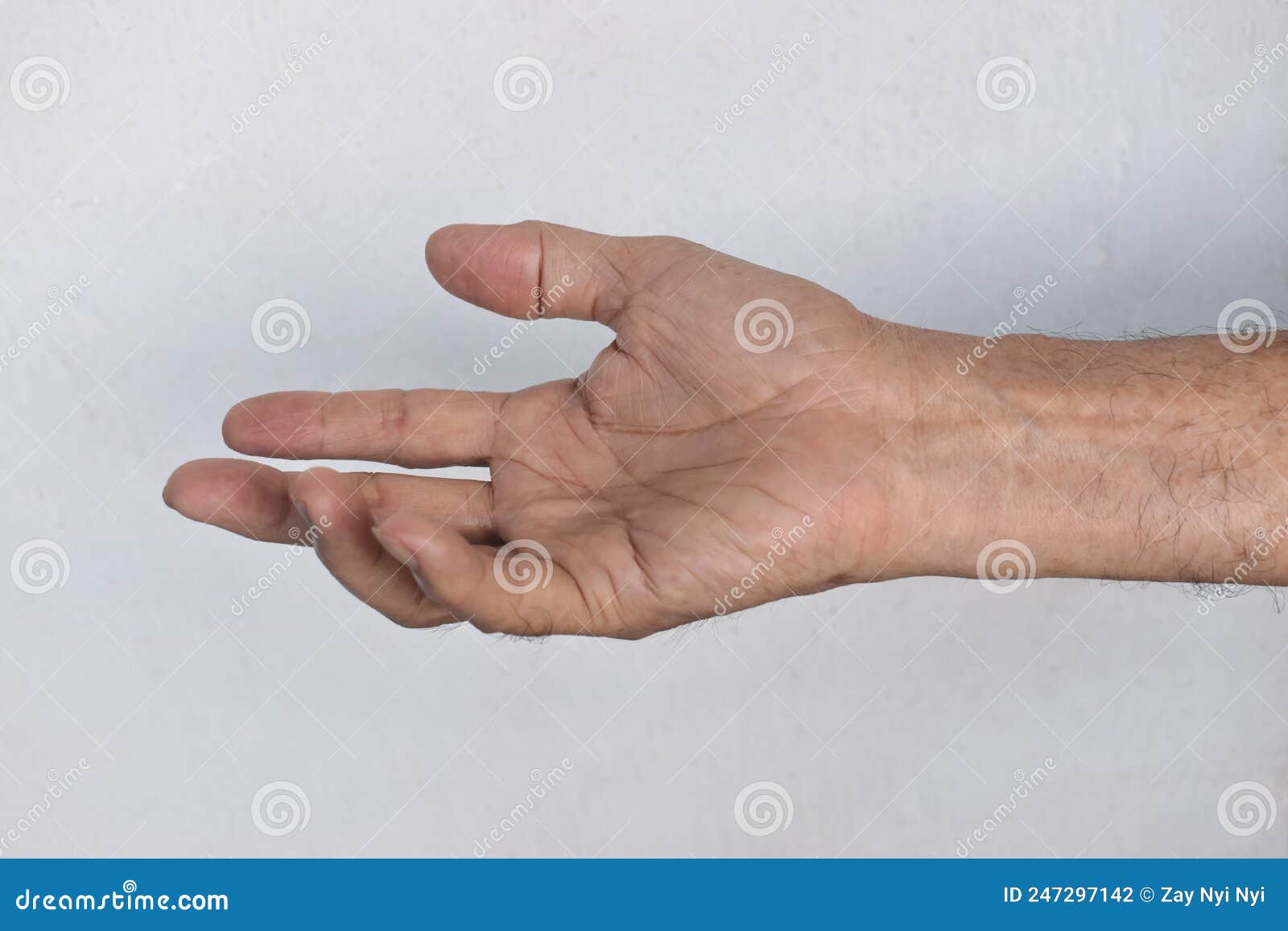 Ulnar Claw Hand Of Asian Old Man. Also Known As `spinster`s Claw Stock ...