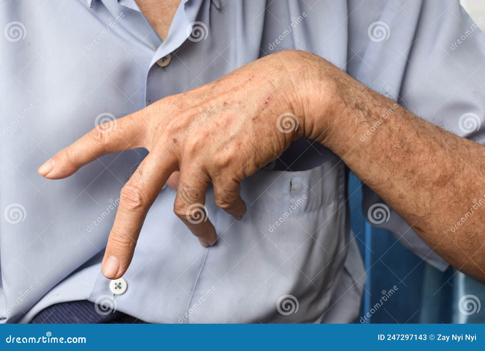 Ulnar Claw Hand of Asian Elder Man. Also Known As & X27;spinster& X27;s ...