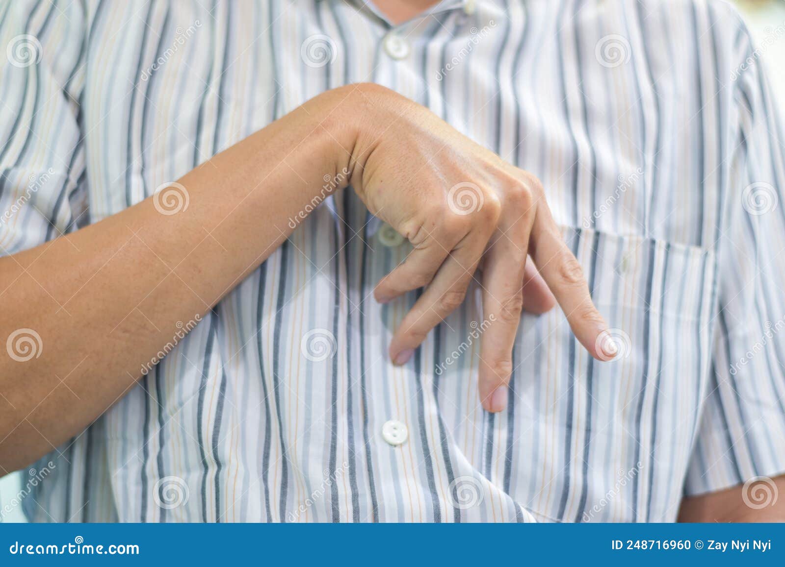 Ulnar Claw Hand of Asian Elder Man. Also Known As Spinsters Claw Stock ...