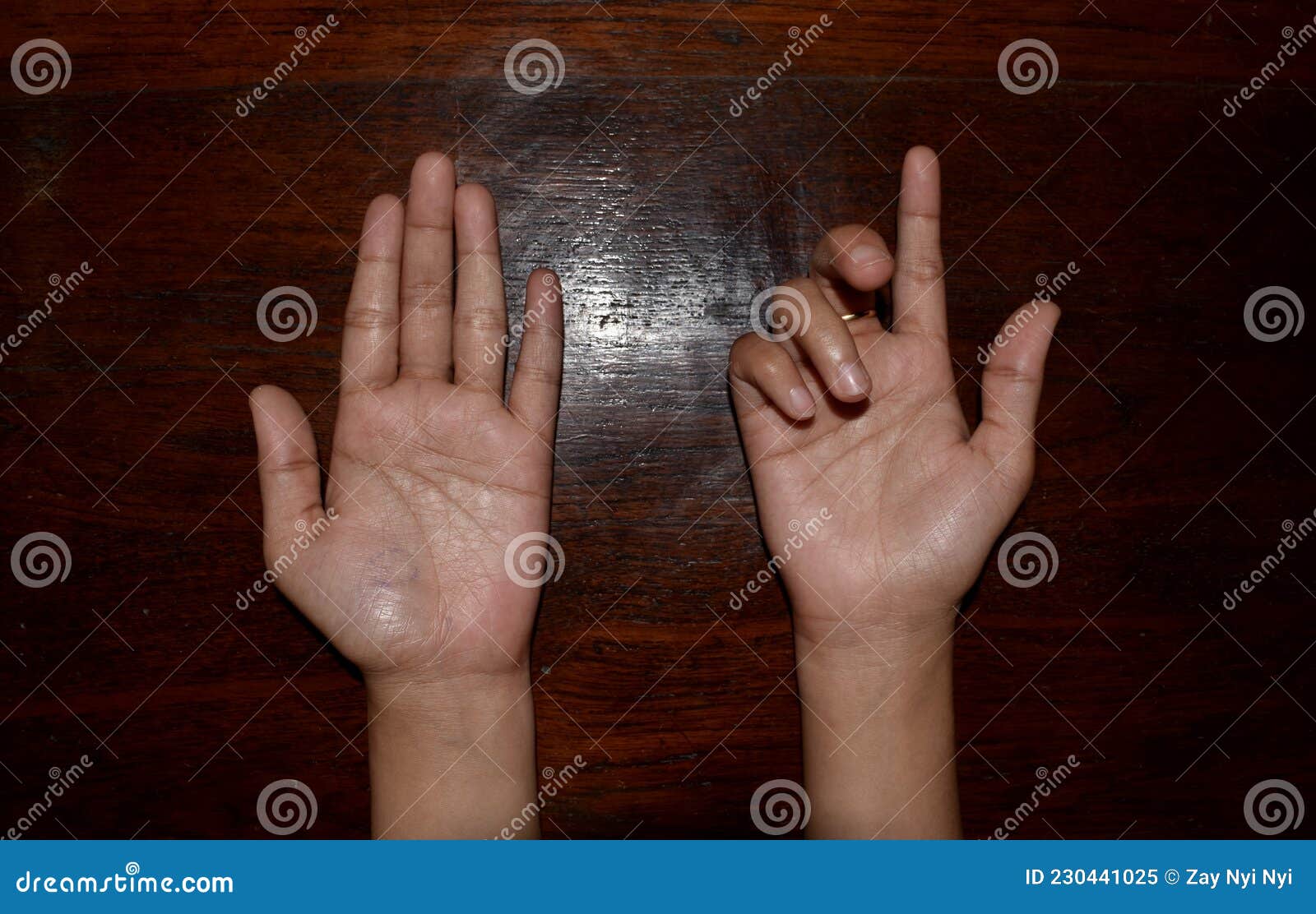 Ulnar Claw Hand Of Asian Young Woman. Also Known As `spinster`s Claw ...