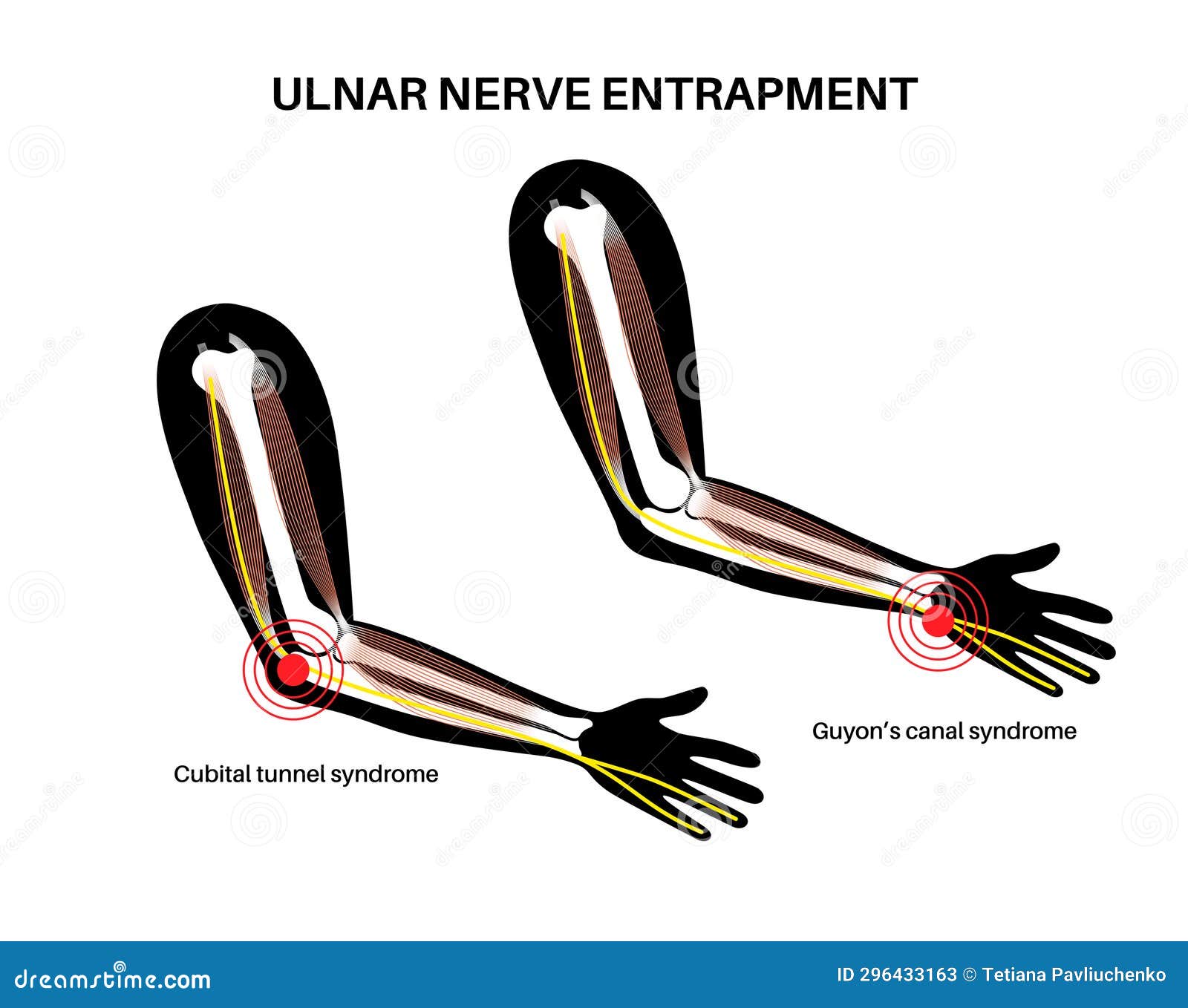 Ulnar Nerve Entrapment Stock Vector Illustration Of Disease 296433163