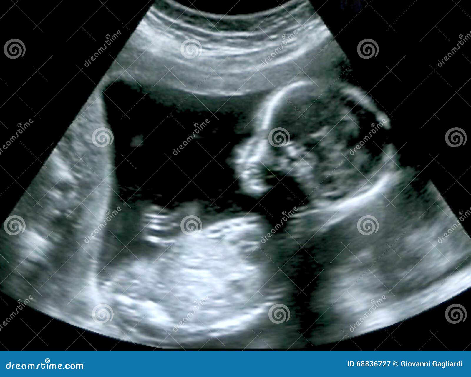 Ultraschall Des Babys in Der Geb5rmutter Der Mutter Stockbild - Bild ...