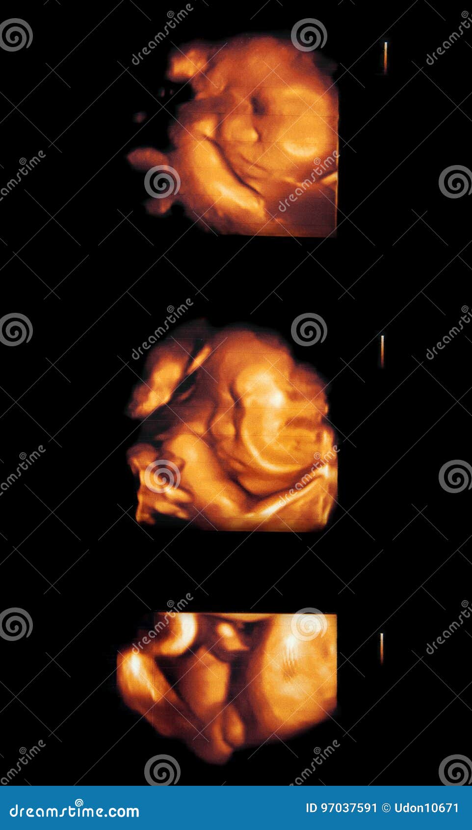 Ultraschall Des Babys in Mutter ` S Geb5rmutter Stockbild - Bild von ...