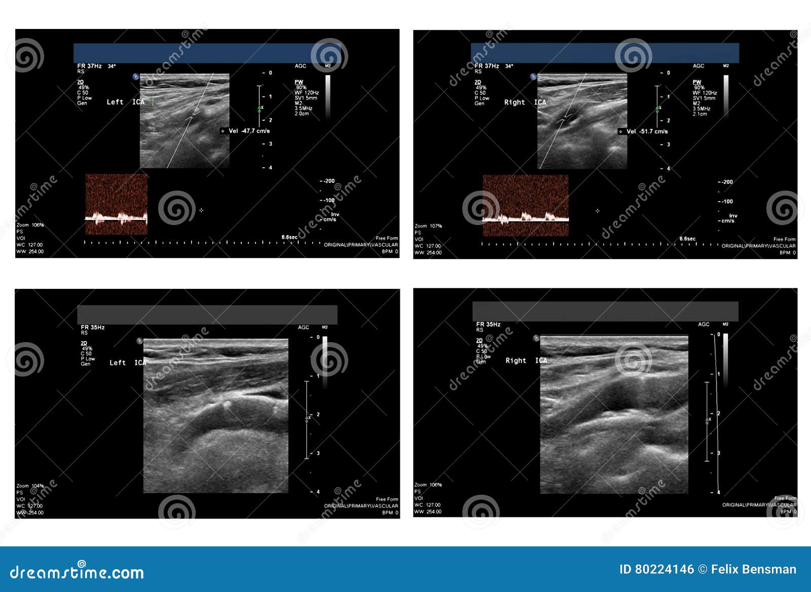 Ultraschallbild Des Halsschlagaders Stockfoto - Bild von vorbereitung ...