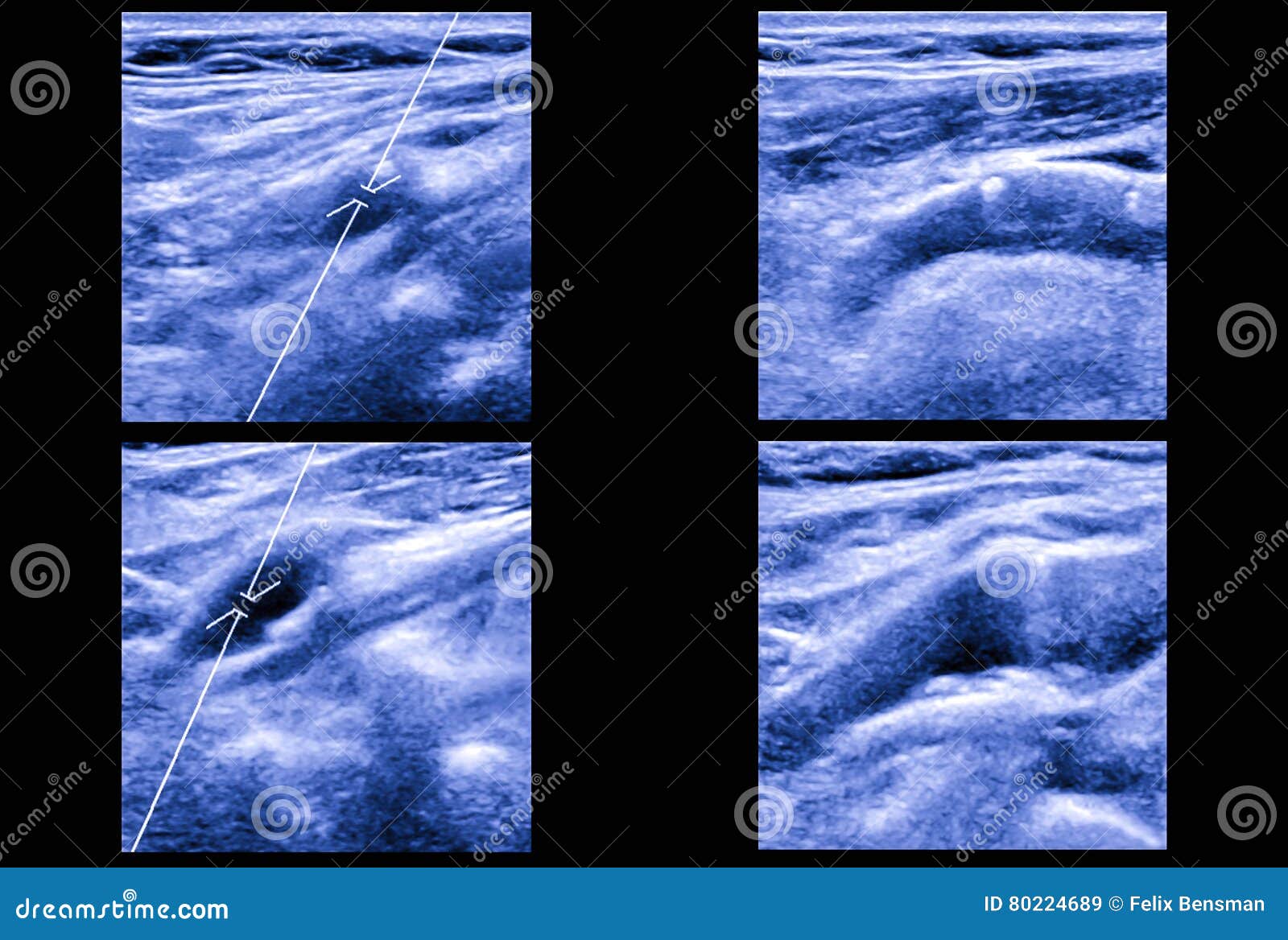 Ultrasone Klankbeeld Van De Slagader Van De Halsslagader Stock ...