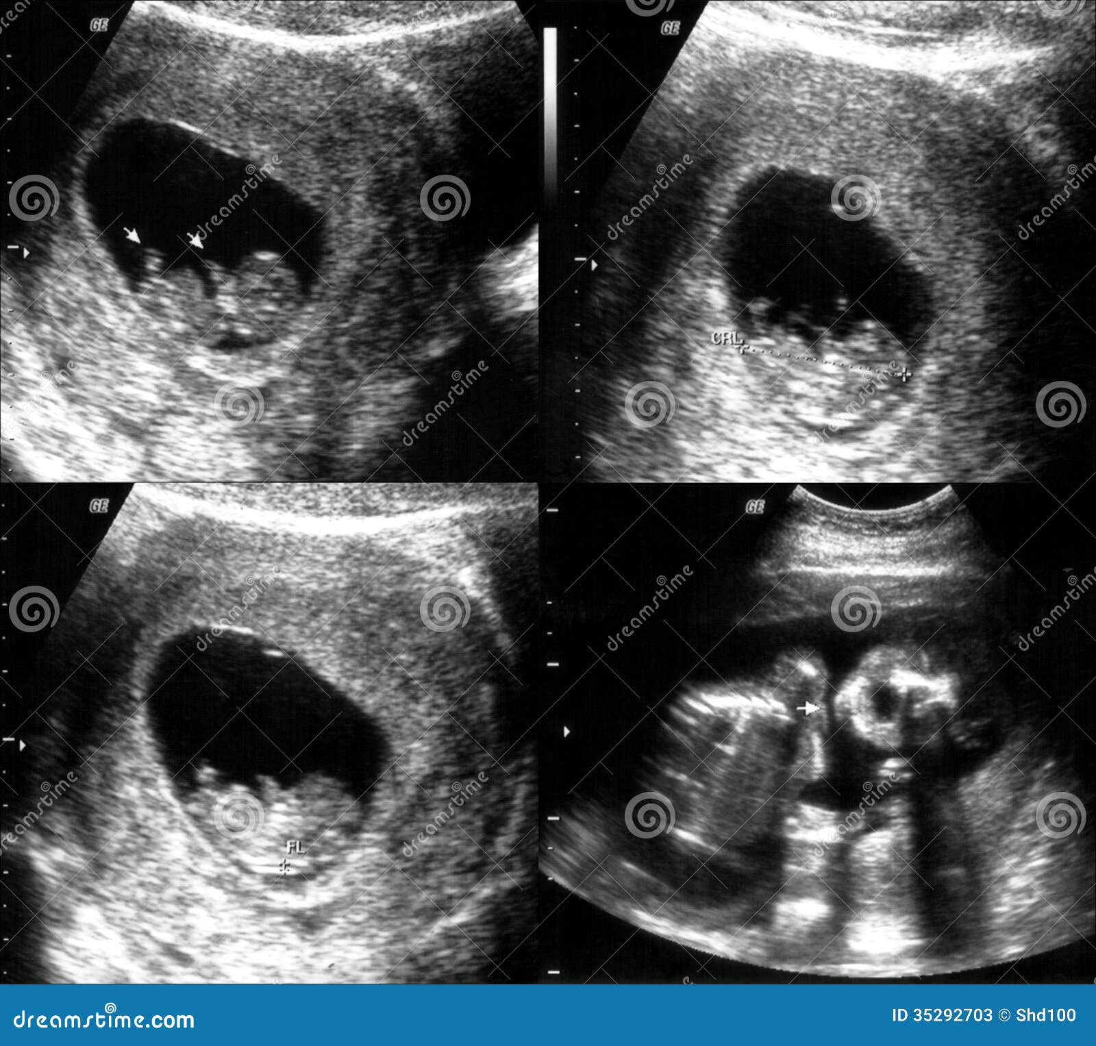 Ultrasonido imagen de archivo. Imagen de médico, salud - 35292703