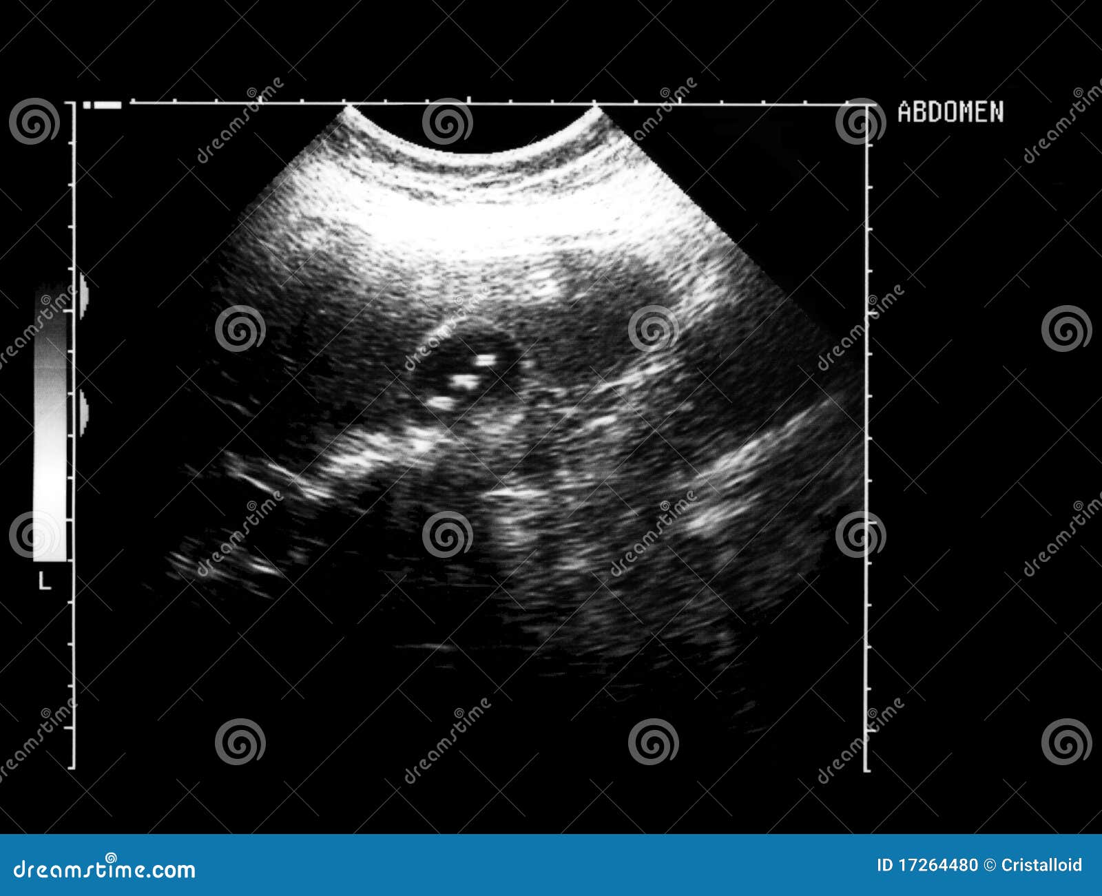 Ultrasonogram of Gall Bladder Stock Photo - Image of doctor, emergency ...