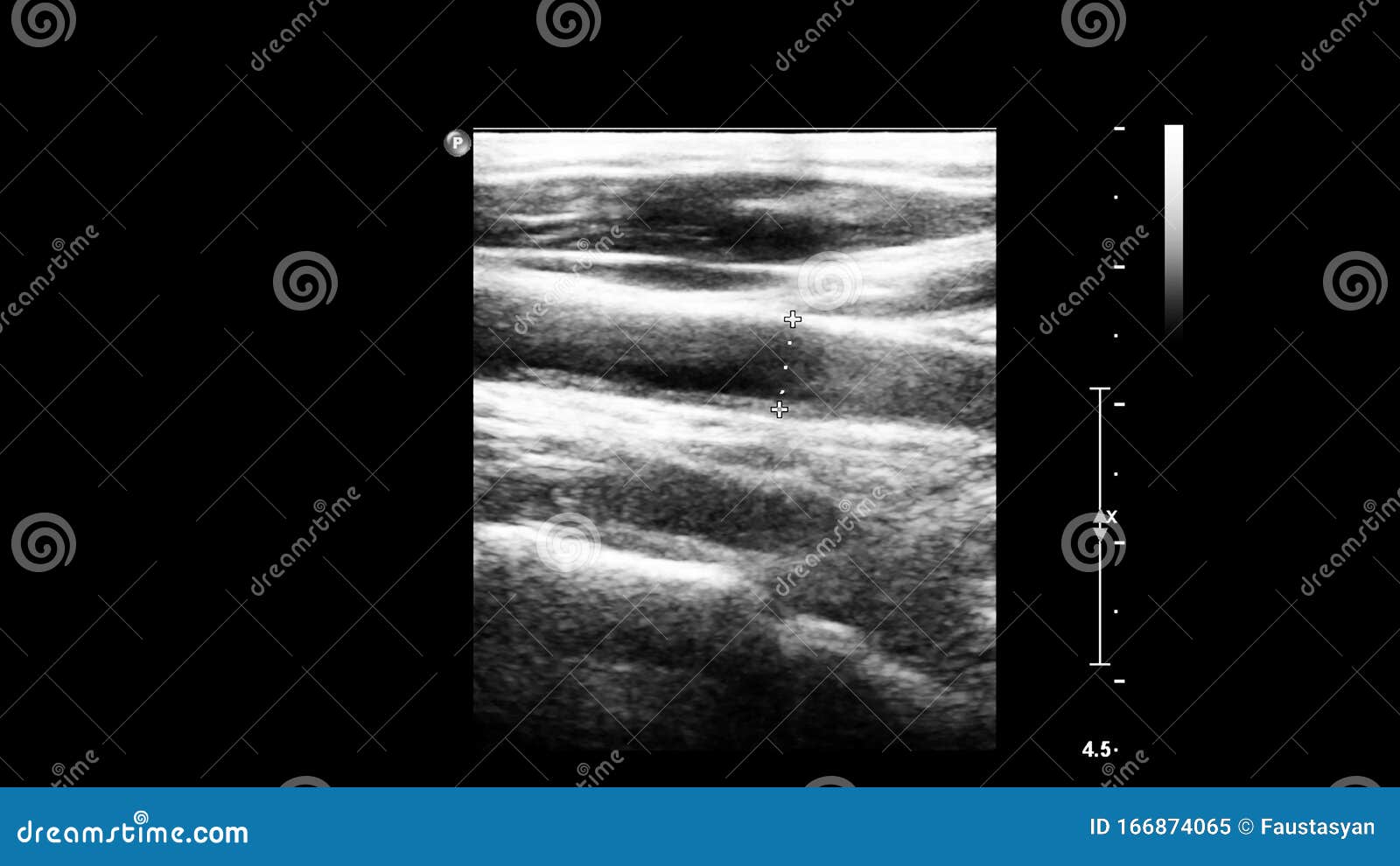 Ultrasound Examination of Blood Vessels in Grayscale Mode. Stock Image ...