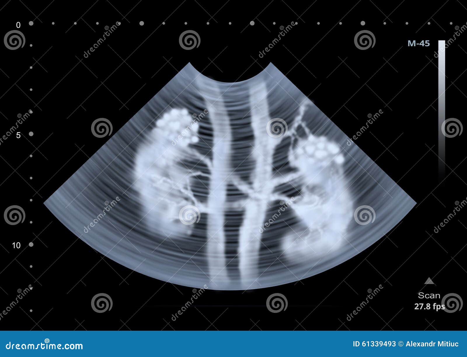 Ultrasound Scan of Human Kidneys Stock Illustration - Illustration of ...