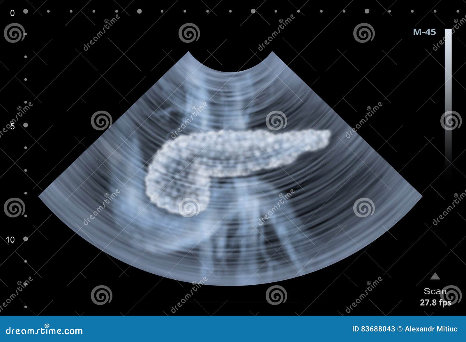 Ultrasound Of Pancreas Doctors Examine, Treat Pancreatitis. Stethoscope ...