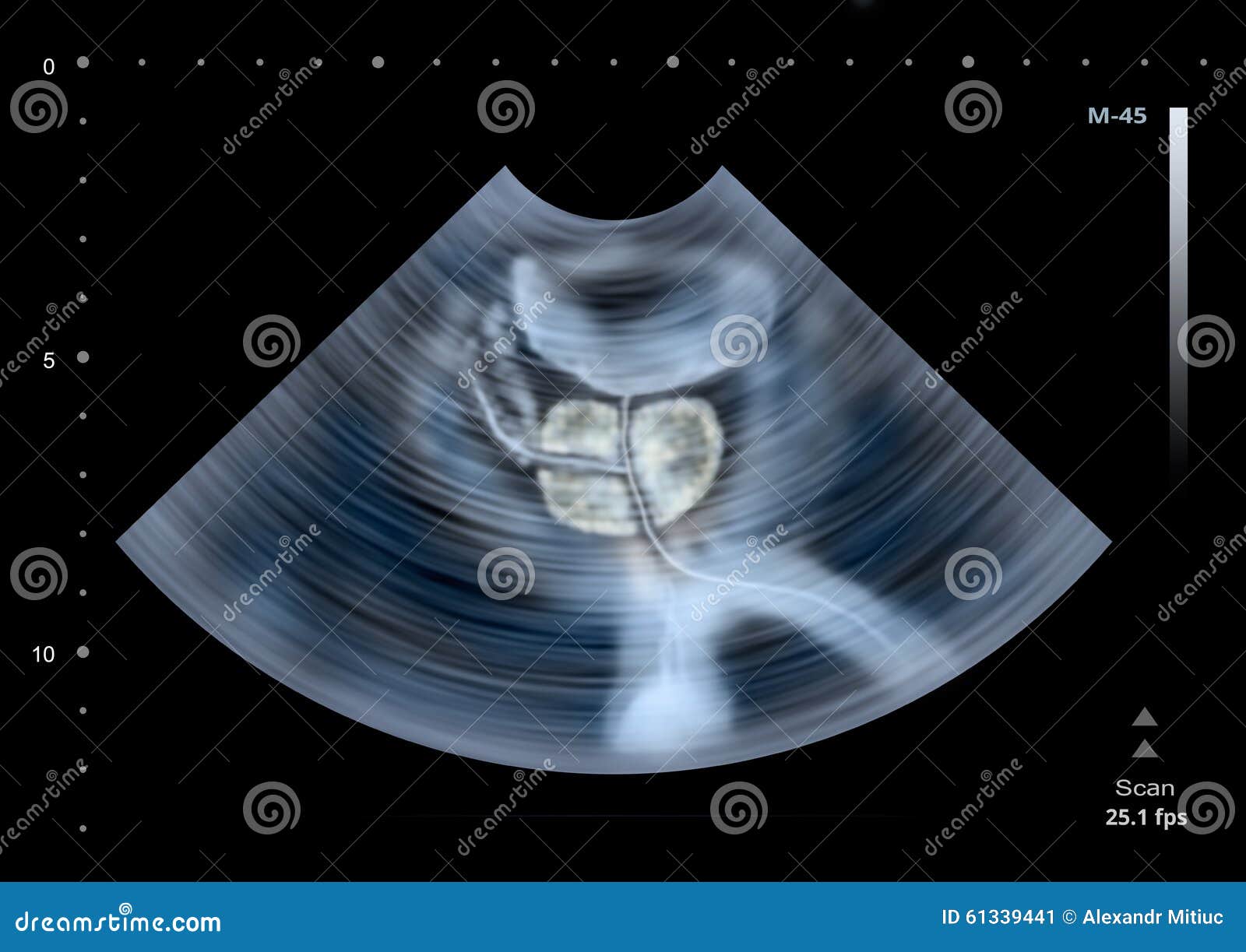 Ultrasound Scan of Human Prostate Stock Illustration - Illustration of ...