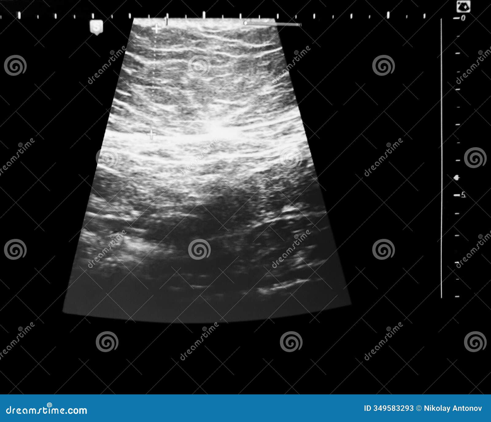 Ultrasound of the Soft Tissues of the Anterior Abdominal Wall Stock ...