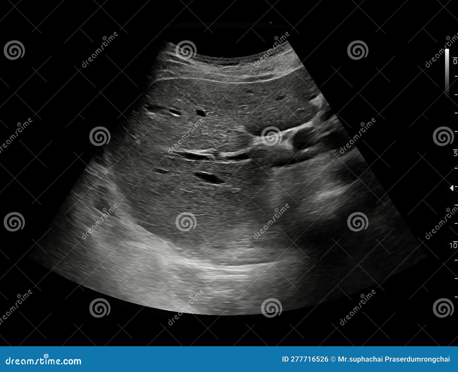 Ultrasound Upper Abdomen Showing Liver And Gall Bladder For Screening