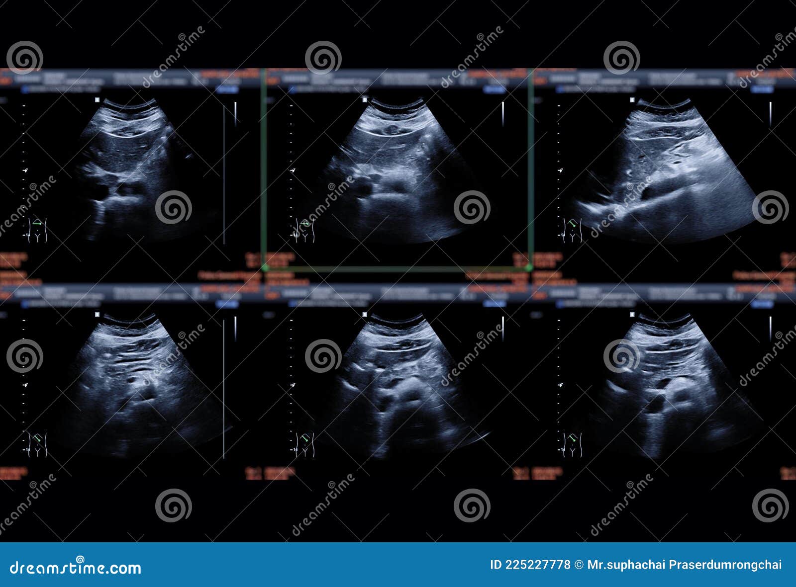 Ultrasound Upper Abdomen Showing Liver ,kidney, Pancrease and Gall ...