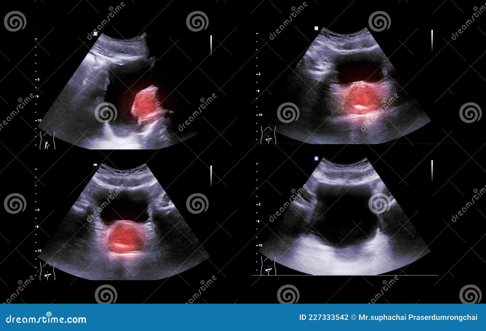 Ultrasound of Urinary Bladder or KUB for Screening Renal and Bladder ...