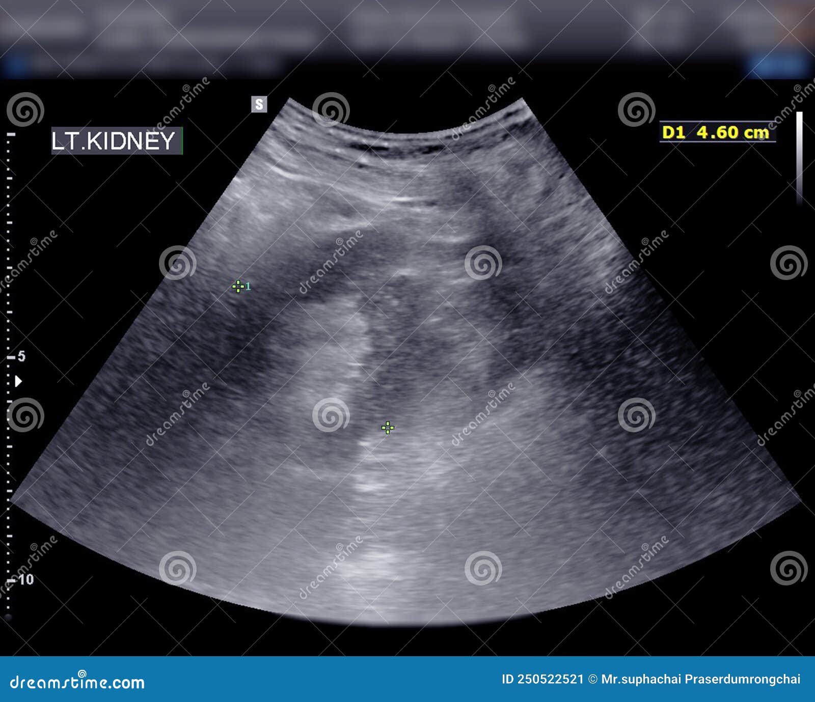 Ultrasound of Urinary Bladder or KUB. Stock Image - Image of dilatation ...