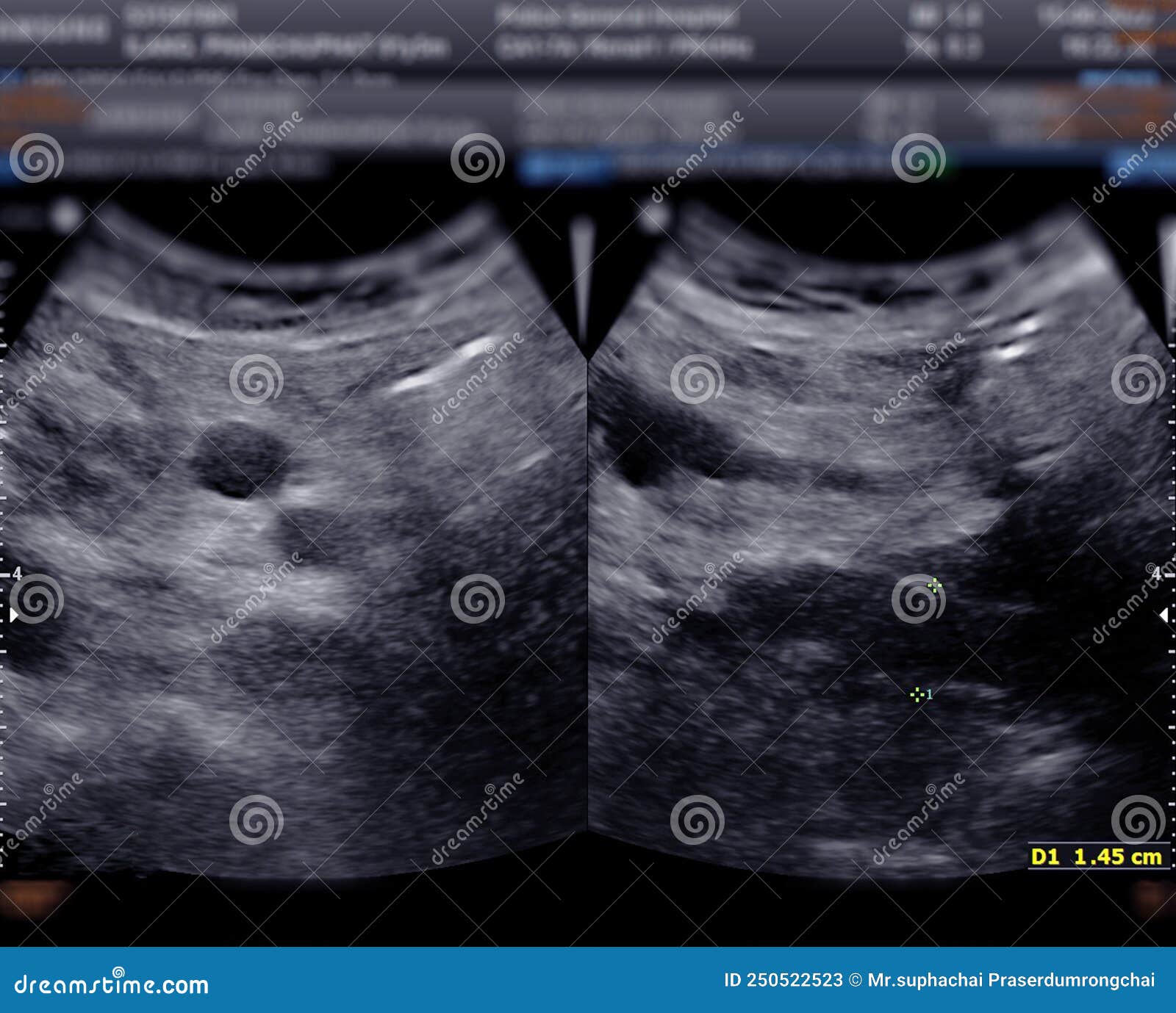 Ultrasound of Urinary Bladder or KUB. Stock Image - Image of anatomy ...