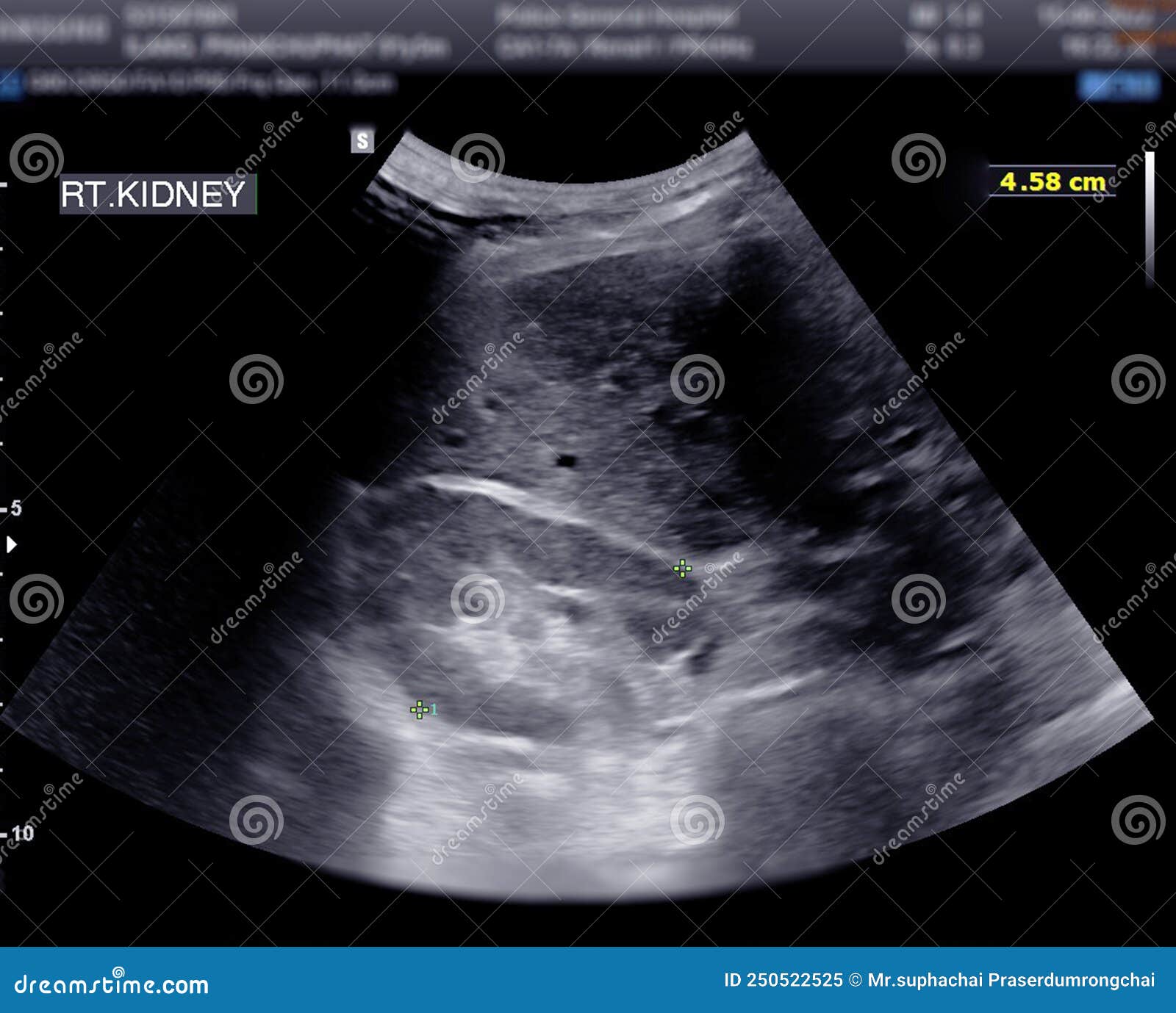 Ultrasound of Urinary Bladder or KUB. Stock Image - Image of gland ...