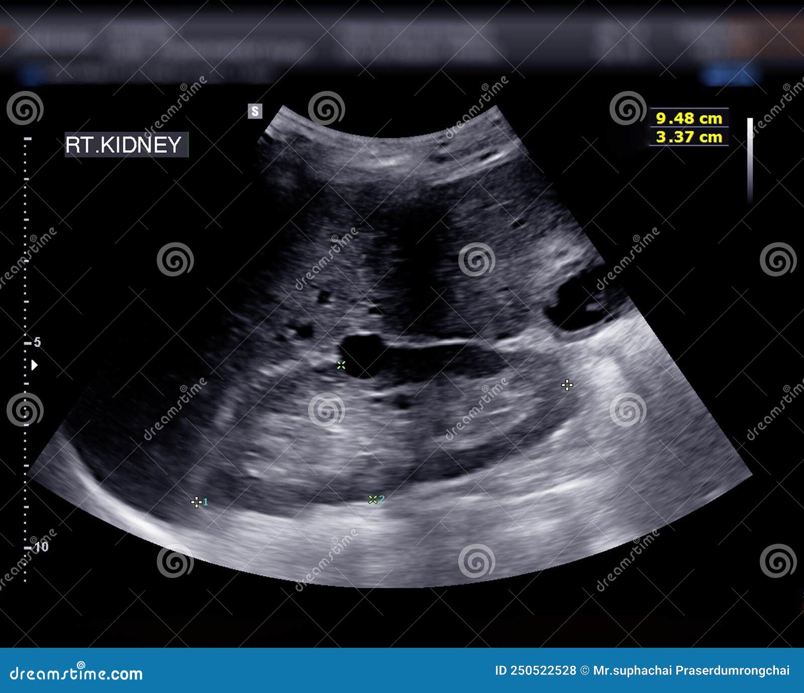 Ultrasound of Urinary Bladder or KUB. Stock Photo - Image of kidney ...