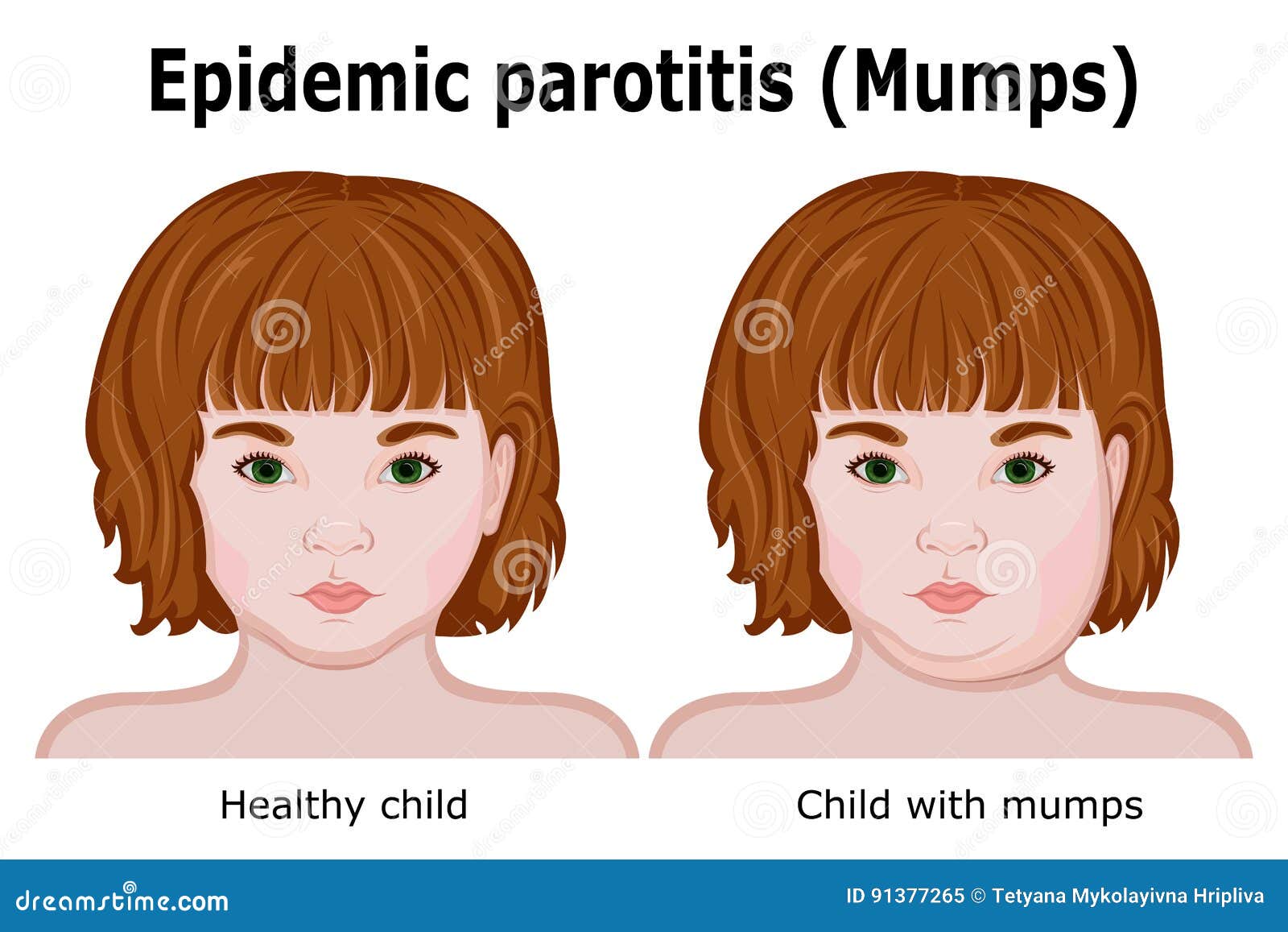 Uma Criança Com Sintomas Da Papeira Ilustração do Vetor - Ilustração de ...