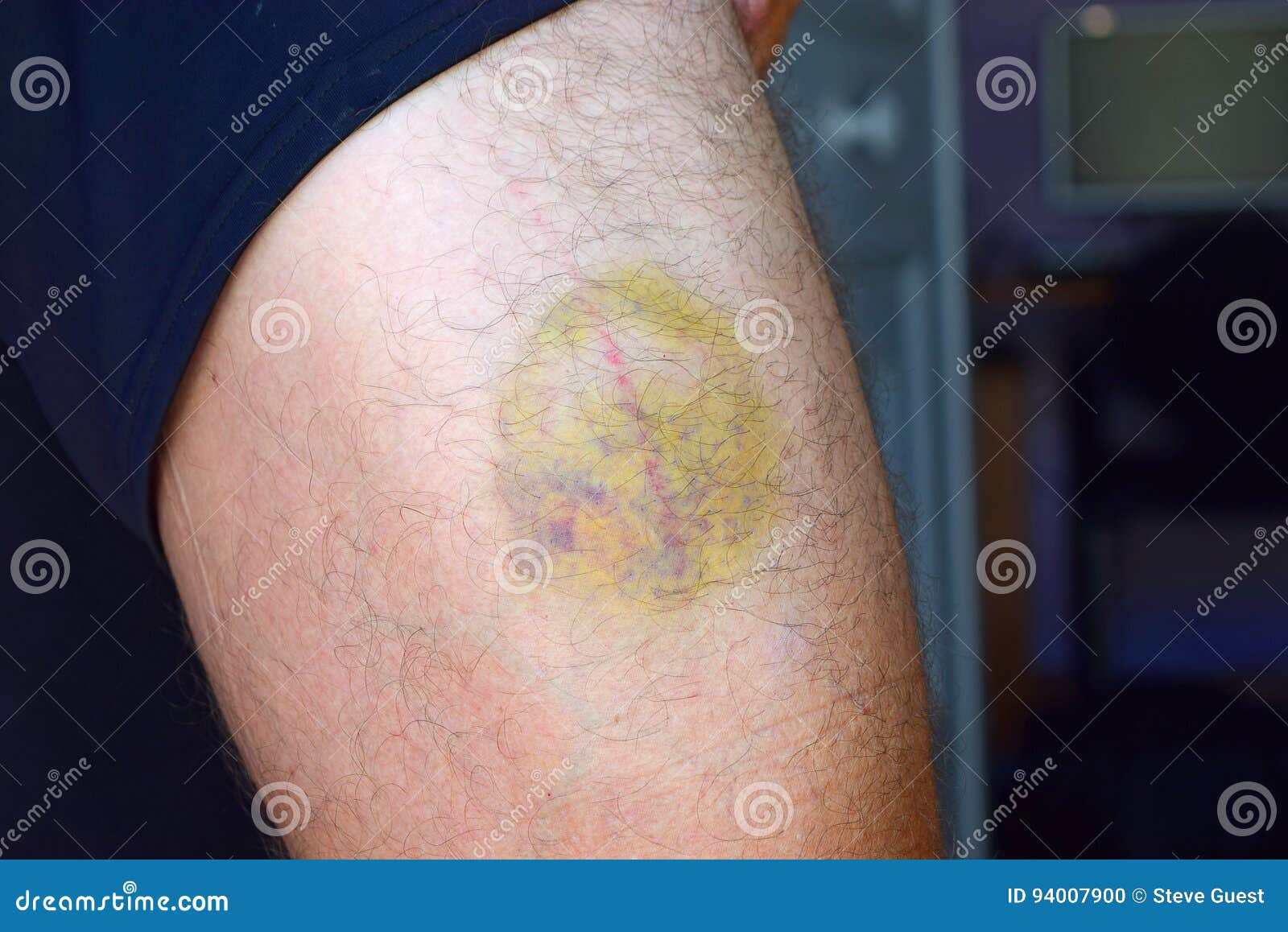 Uma equimose foto de stock. Imagem de severo, violência - 94007900