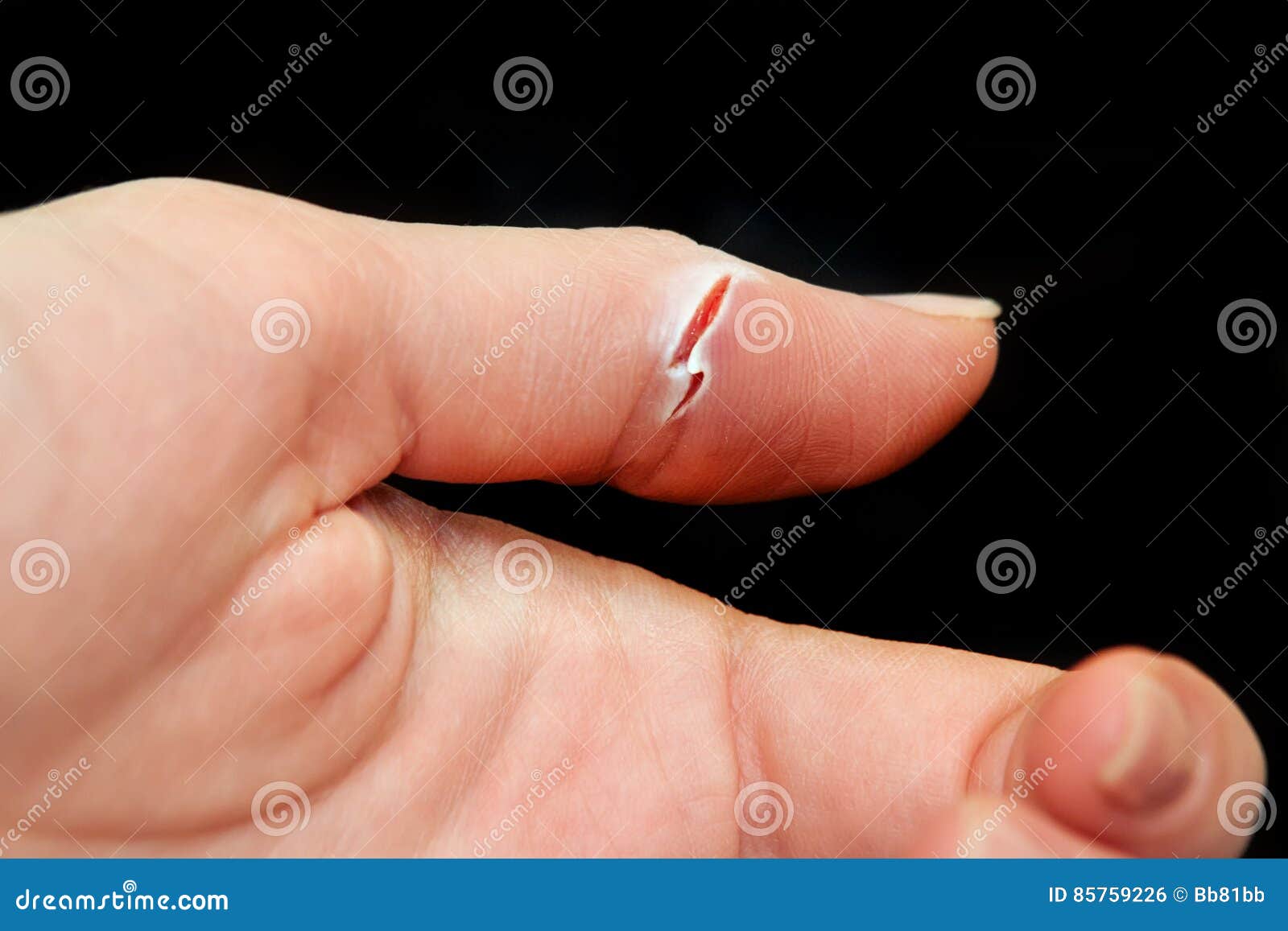 Uma Ferida Profunda No Dedo Foto de Stock - Imagem de perigo, ferido ...