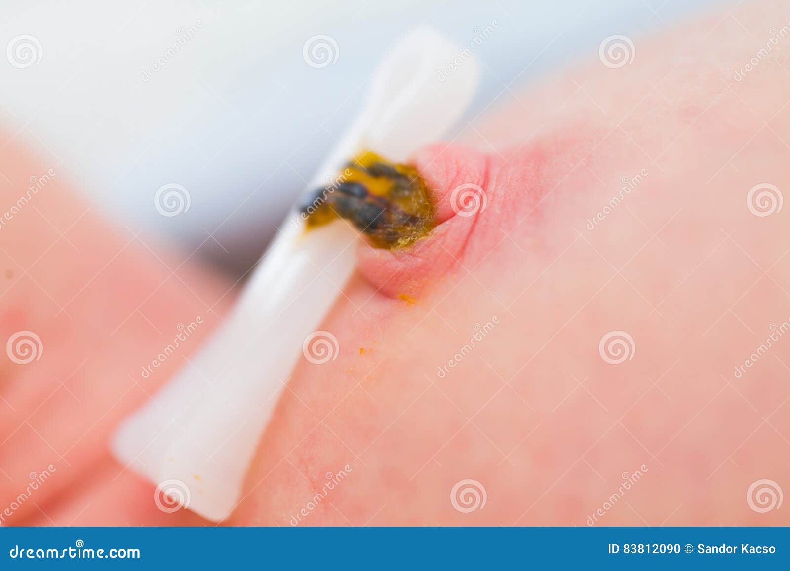 Umbilical cord stock photo. Image of girl, hospital, falling - 83812090