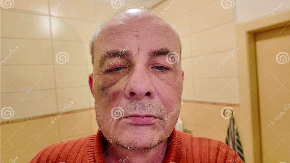Un Anciano Examina El Hematoma En Su Ojo En El Espejo. Un Hombre Con ... Un Anciano Examina El Hematoma En Su Ojo En El Espejo. Un Hombre Con ...