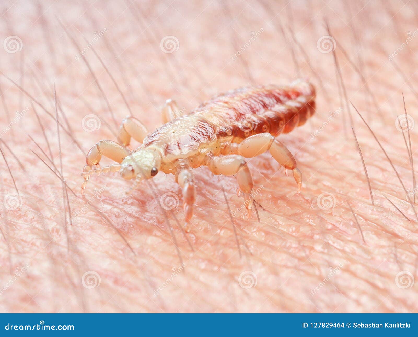 Un pidocchio del capo fotografia stock. Immagine di illustrazione ...