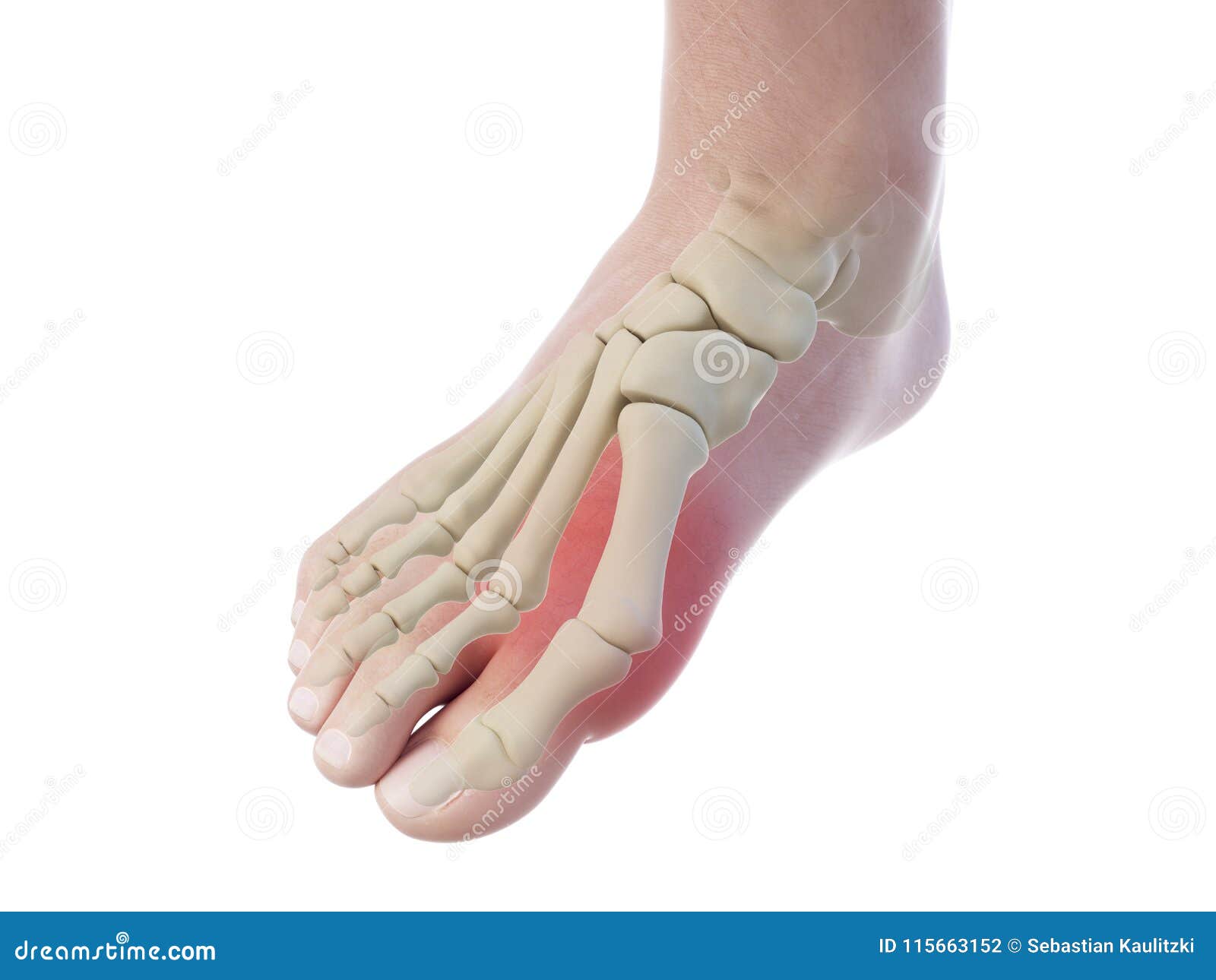 Una borsite dell'alluce illustrazione di stock. Illustrazione di ...