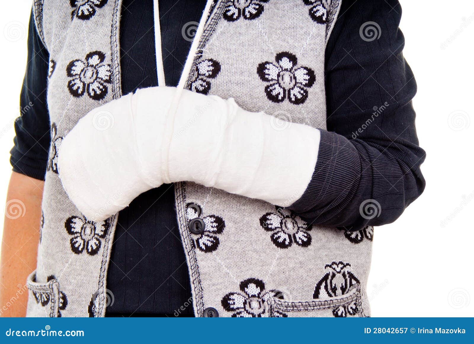 Una Donna Con Un Braccio Rotto Immagine Stock - Immagine di fasciatura ...