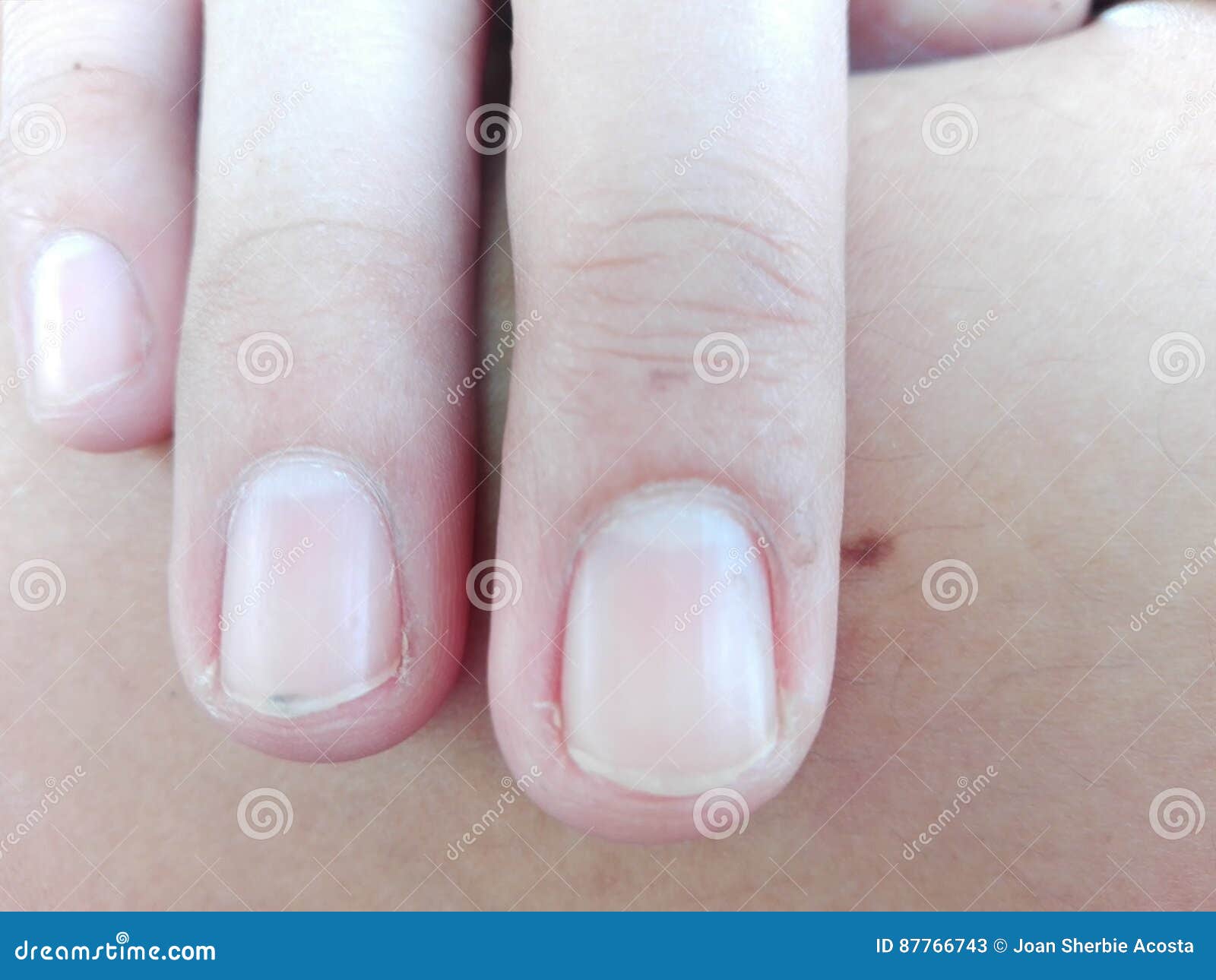 Uncut nails stock image. Image of unhealthy, mans, uncut - 87766743