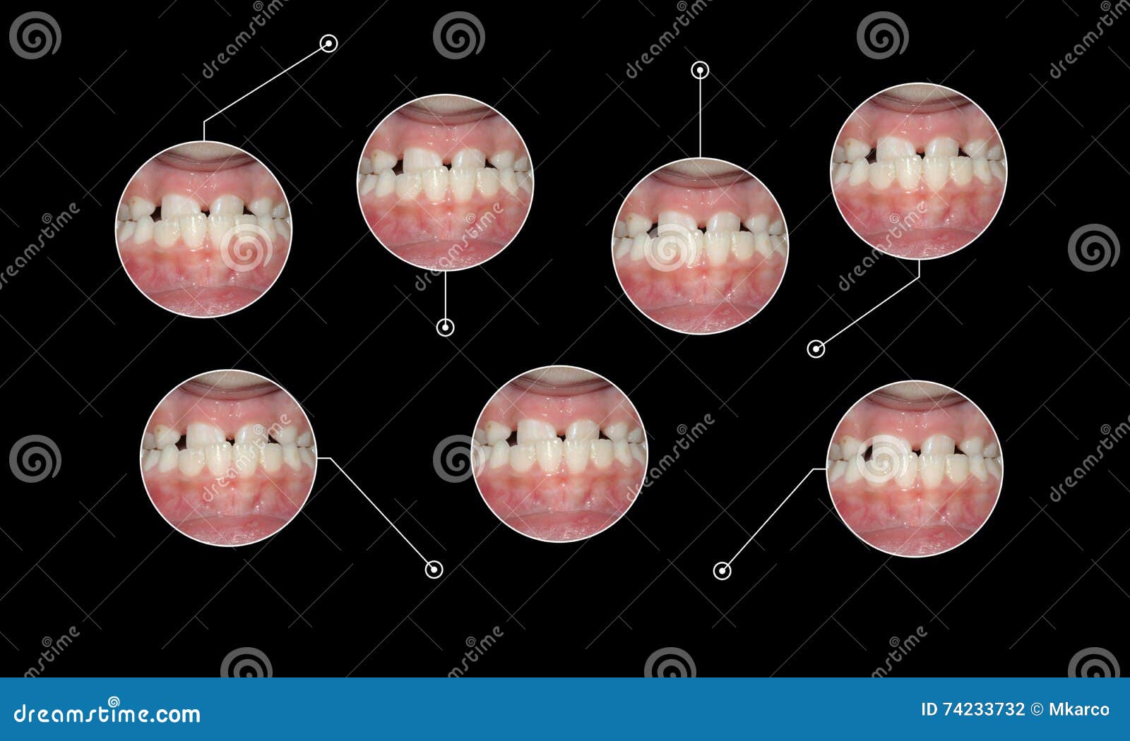 Under Bite Malocclusion Orthodontic Graphic Elements Stock Illustration ...