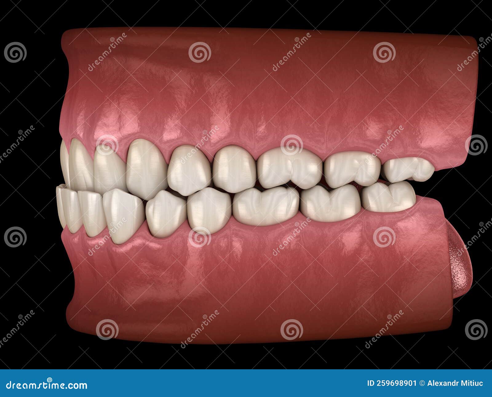 Underbite Dental Occlusion Malocclusion Of Teeth . Medically Accurate ...