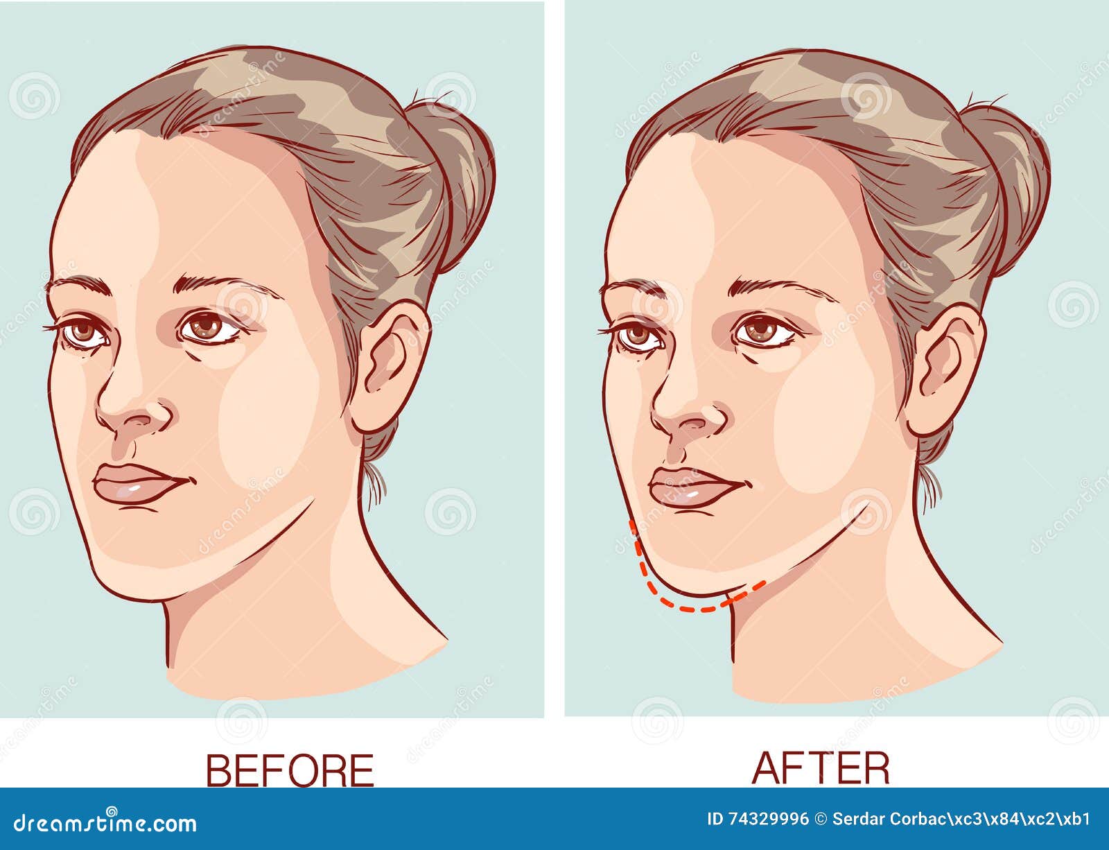 Underbite Jaw Surgery Vector Illustration | CartoonDealer.com #74329996
