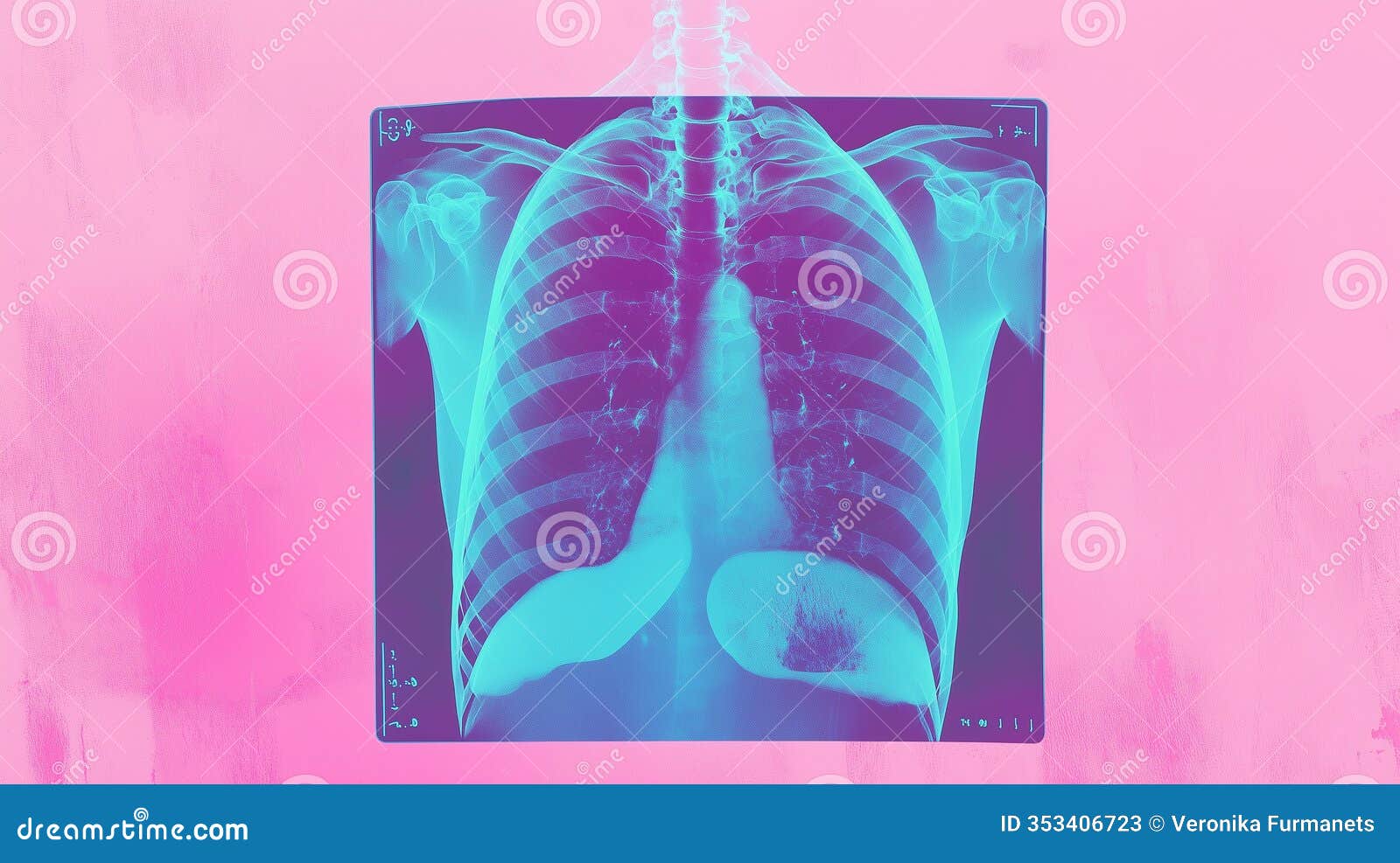 Understanding Chest XRay Anatomy A Visual Guide To Ribs Scapula And ...