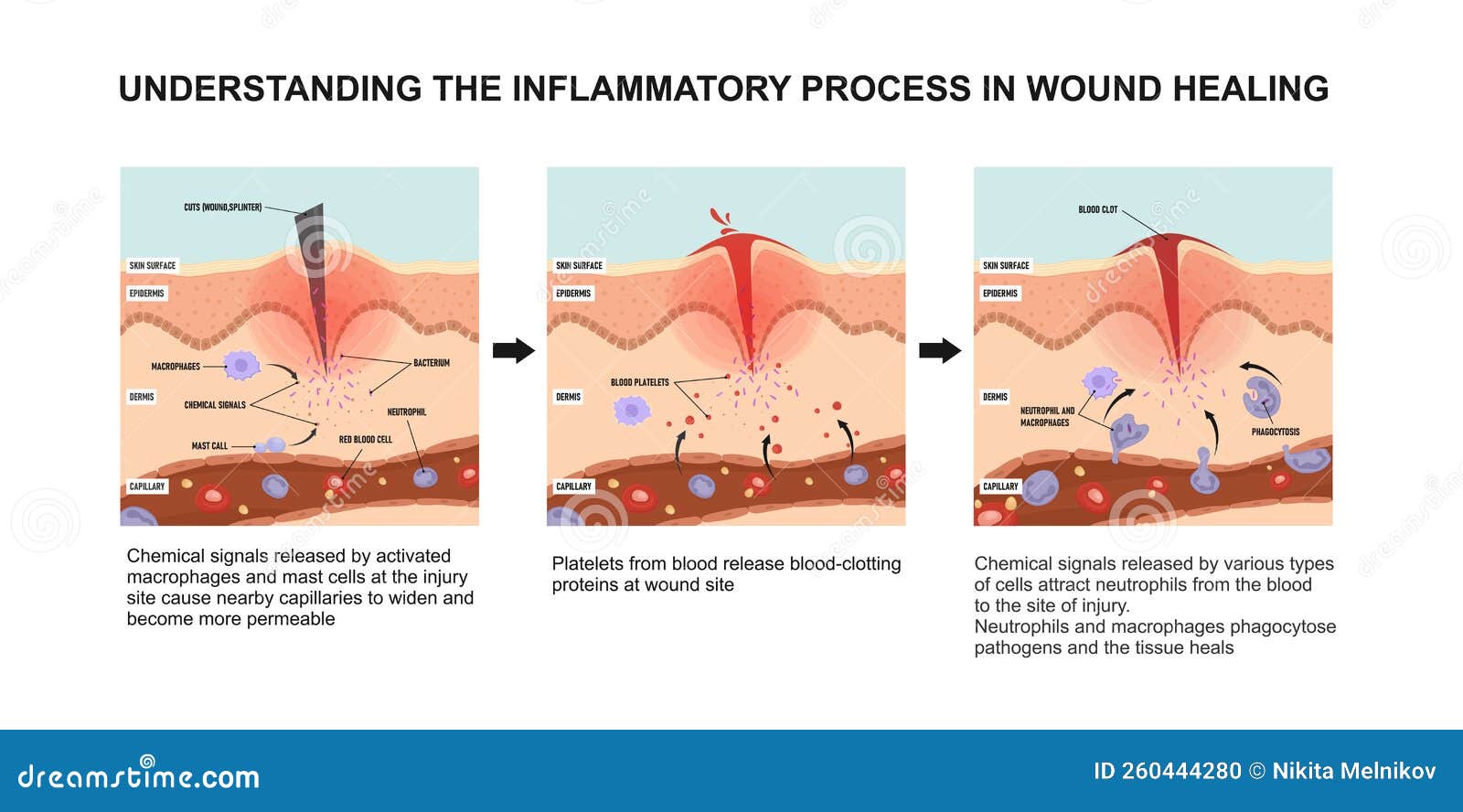 Understanding the Inflammatory Process in Wound Healing Stock Vector ...