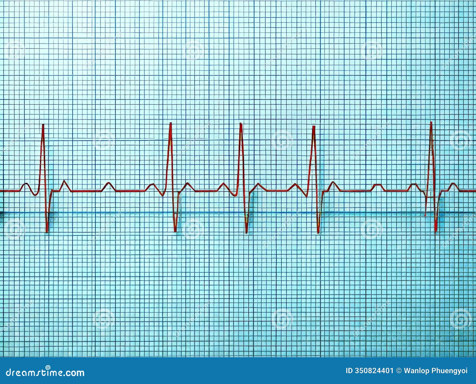 Pacemaker Rhythm Strips