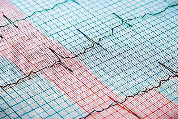 Understanding ST Elevation and Normal ECG Patterns: a Comprehensive ...