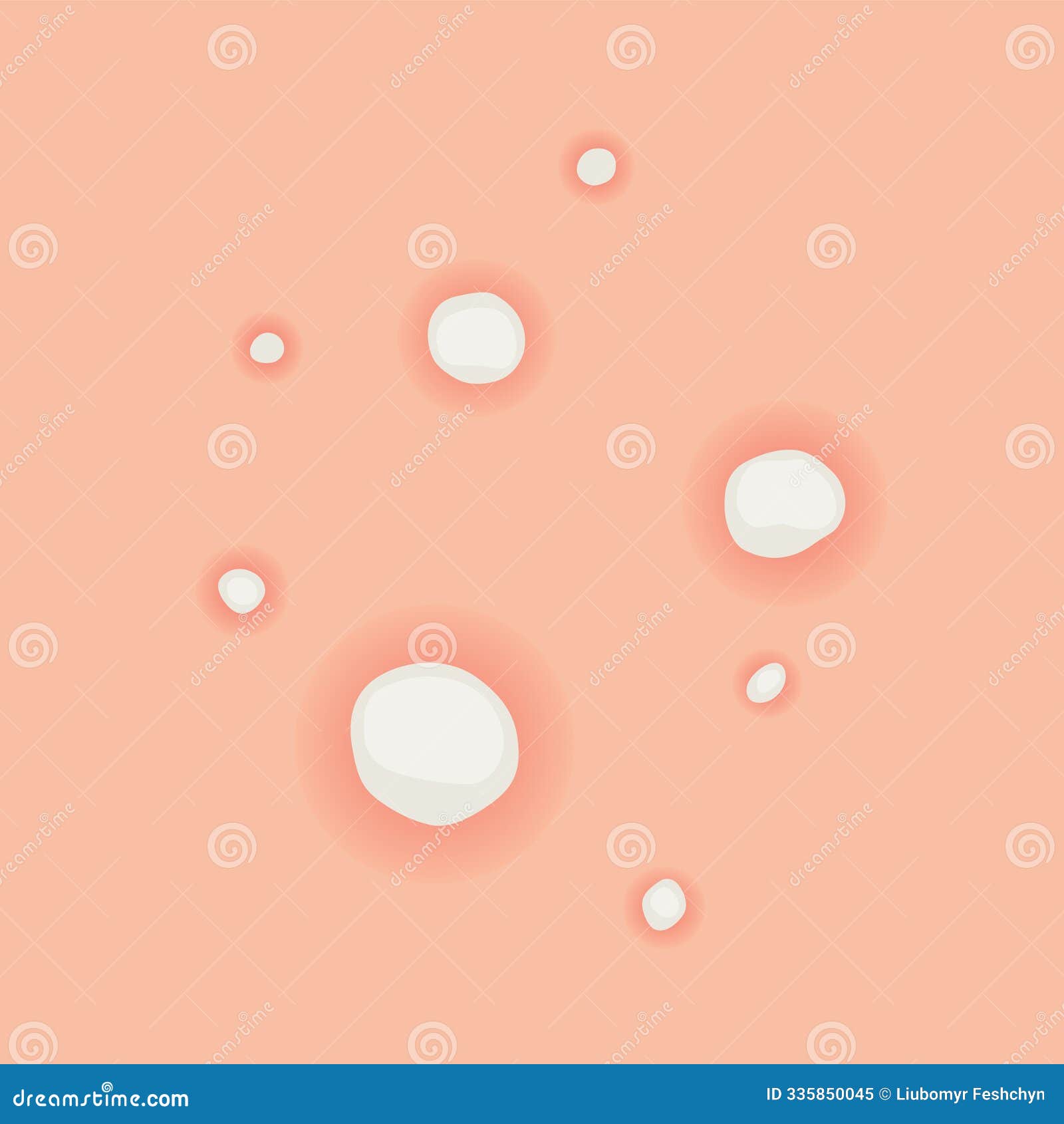 Understanding Type of Acne a Comprehensive Visual Guide for Everyone ... Understanding Type of Acne a Comprehensive Visual Guide for Everyone ...