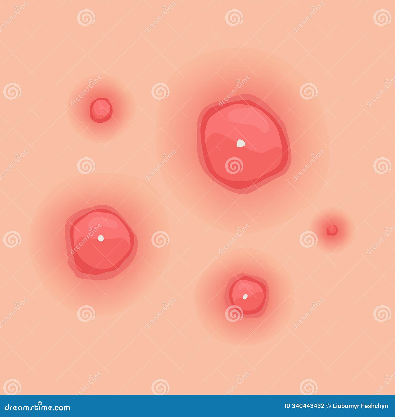 Understanding Type of Acne a Comprehensive Visual Guide for Everyone ...