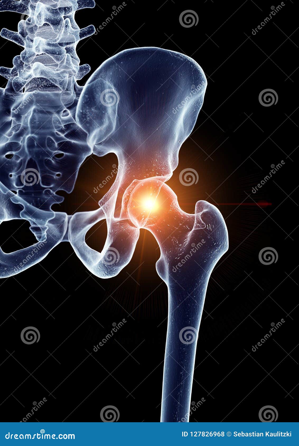 Une Articulation De La Hanche Douloureuse Illustration Stock ...